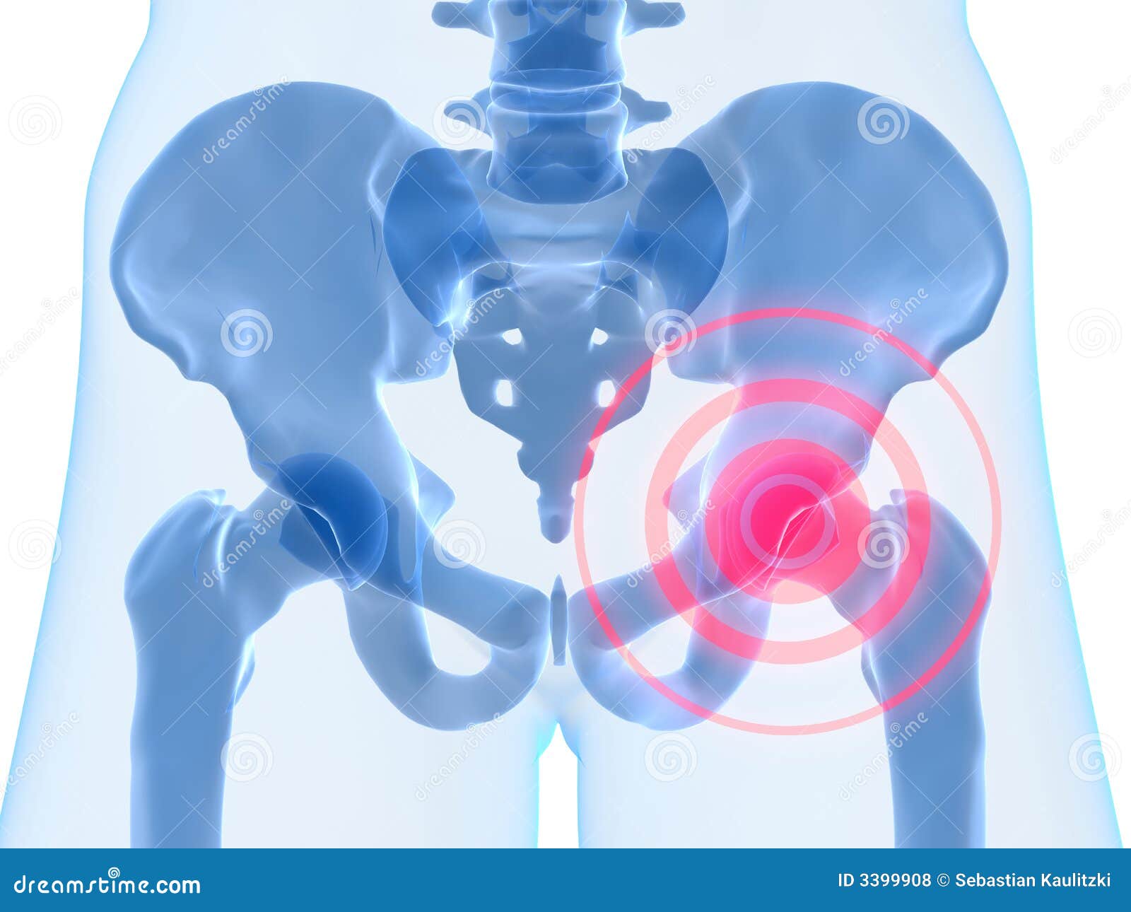 De ontsteking van de heup stock illustratie. Illustration of menselijk ...