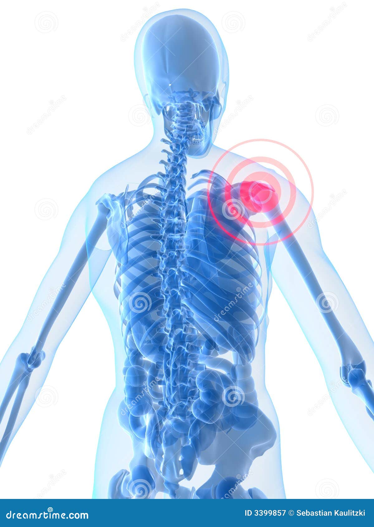 De Ontsteking Van De Schouder Stock Illustratie - Illustration of ...