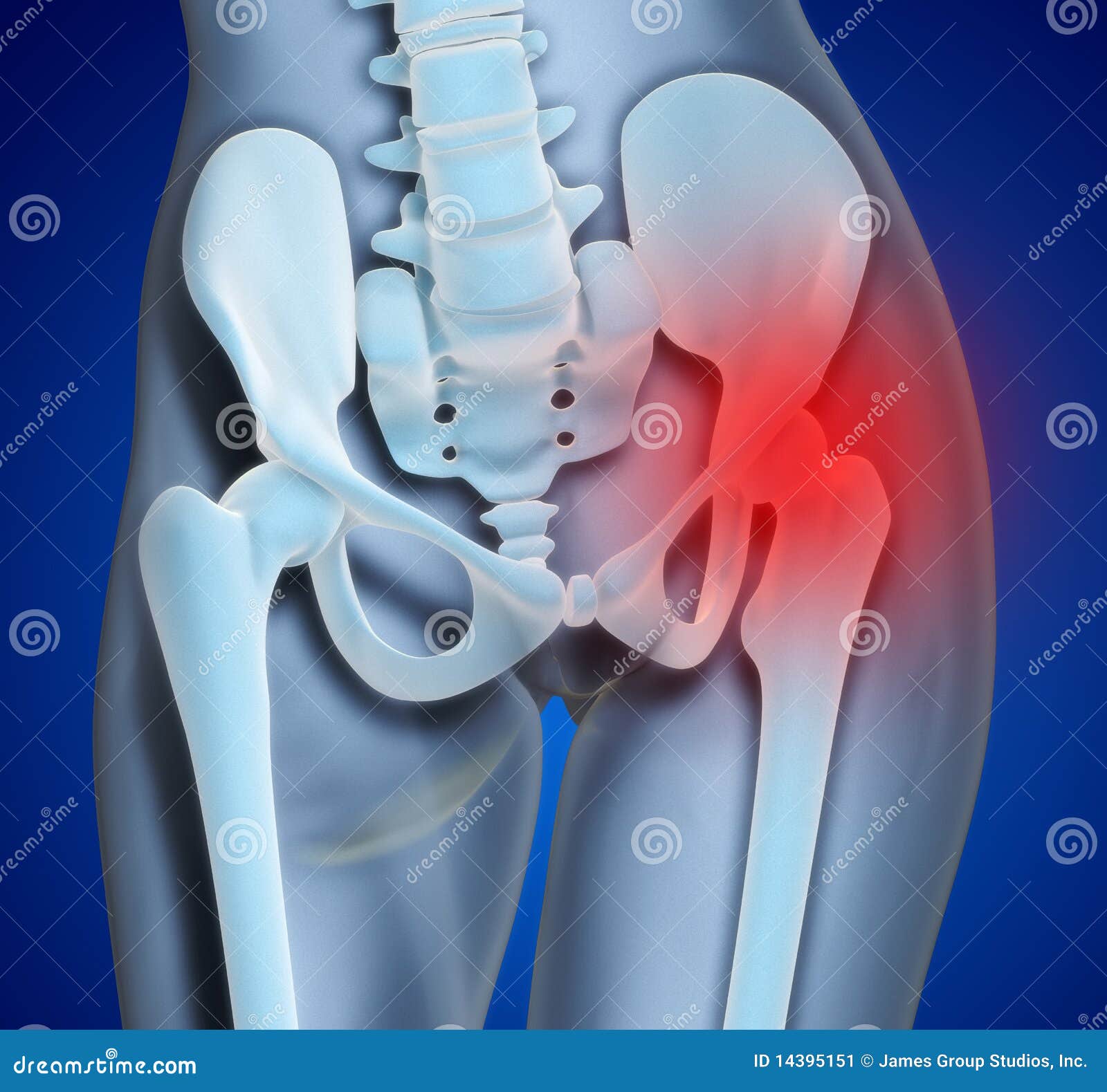 De Pijn van de heup stock illustratie. Illustration of ziekenhuis ...