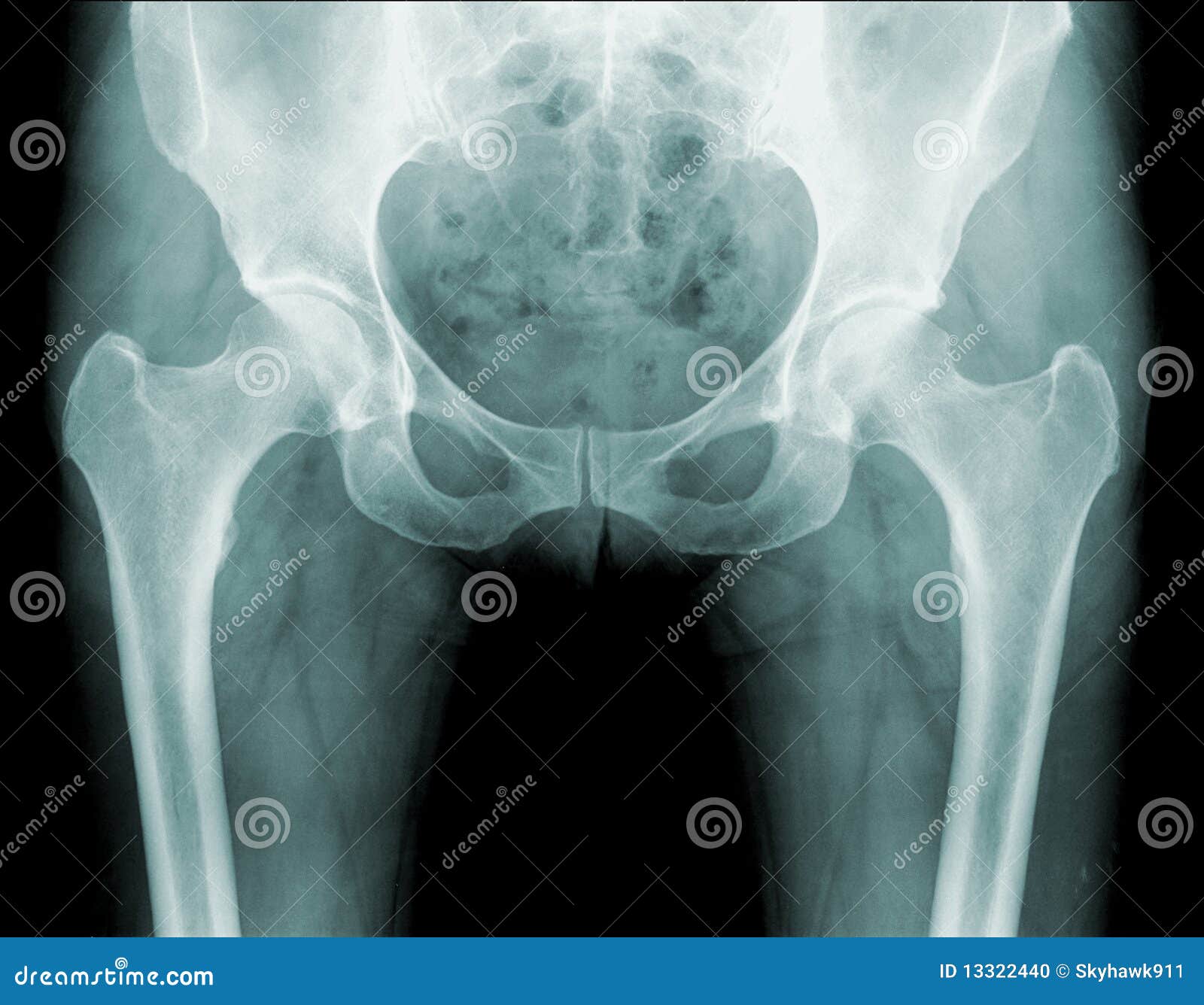 De Röntgenstraal Van De Heup, Heuppijn Stock Foto - Image of examen ...