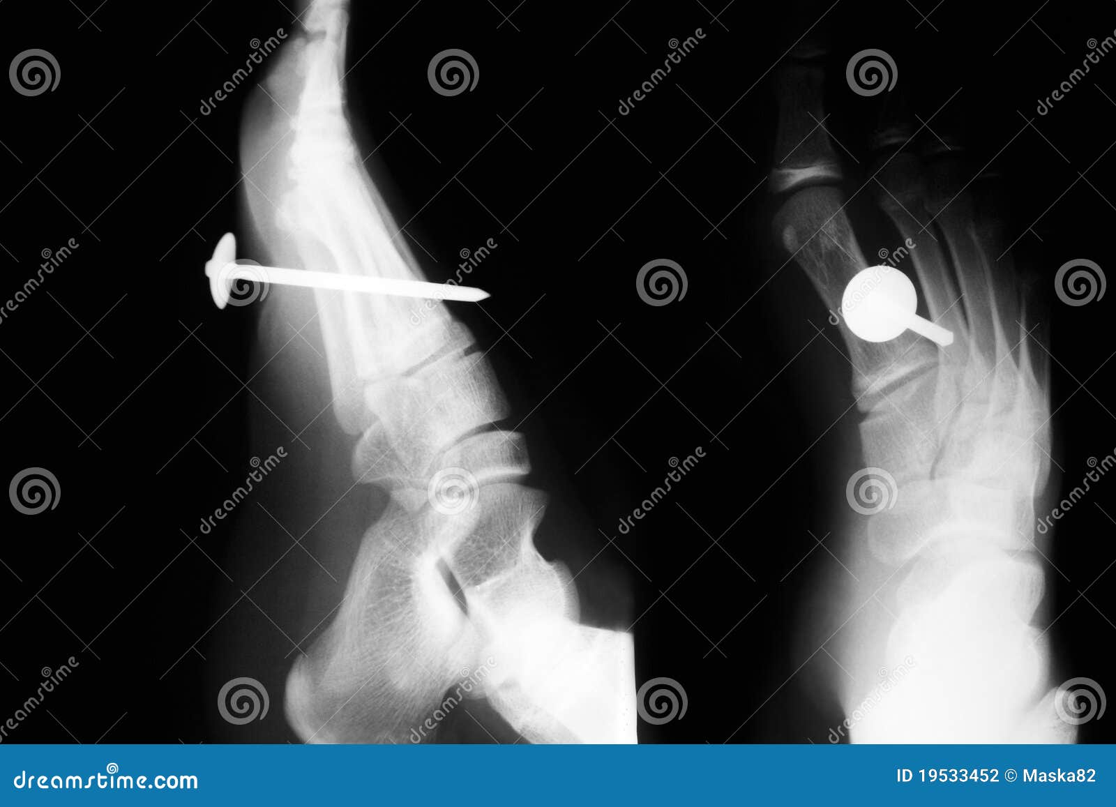 De Röntgenstraal Van De Voet Stock Foto - Image of geduldig, anatomie ...