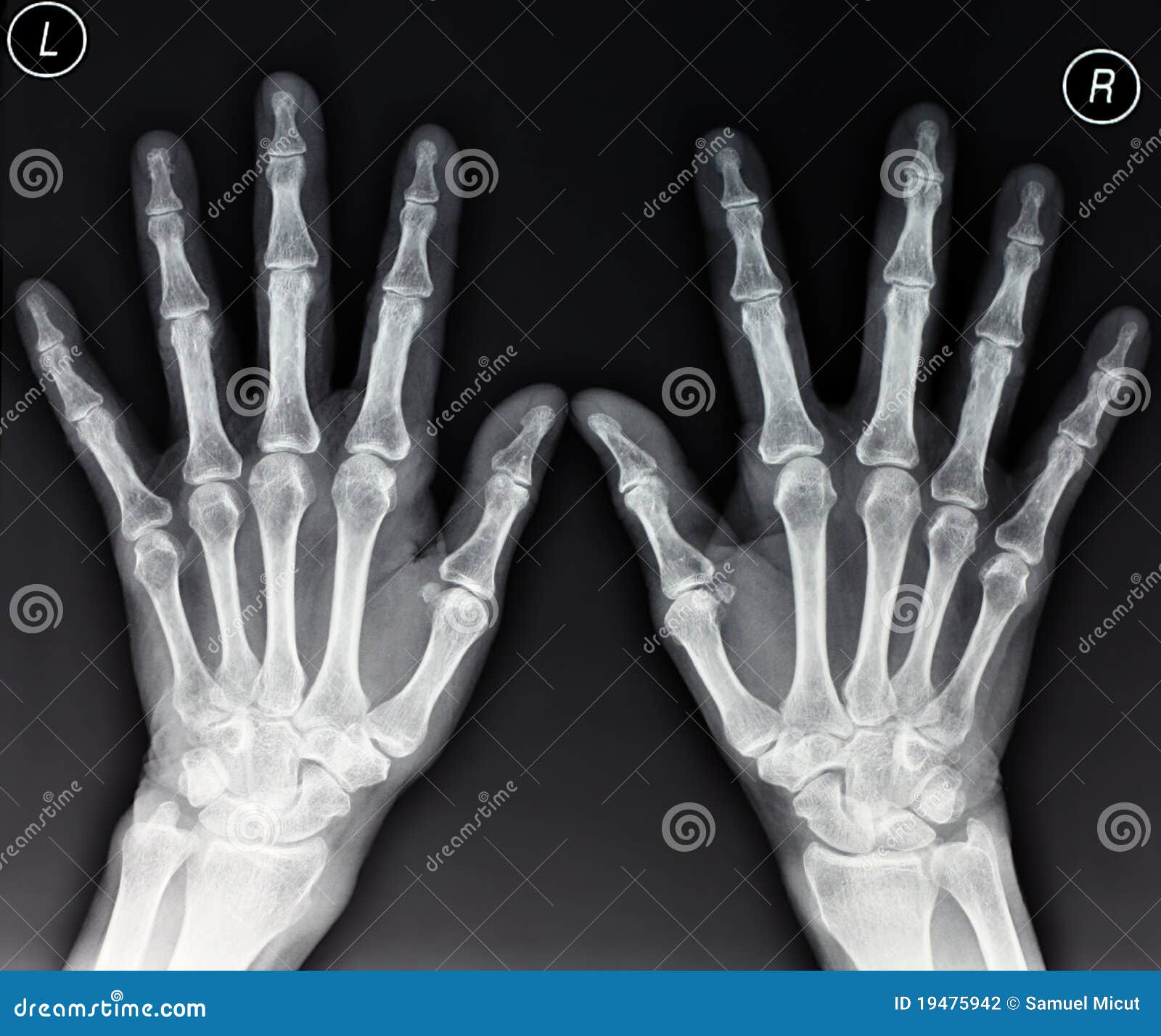 De Röntgenstraal Van Handen Stock Foto - Image of radiografie, aftasten ...