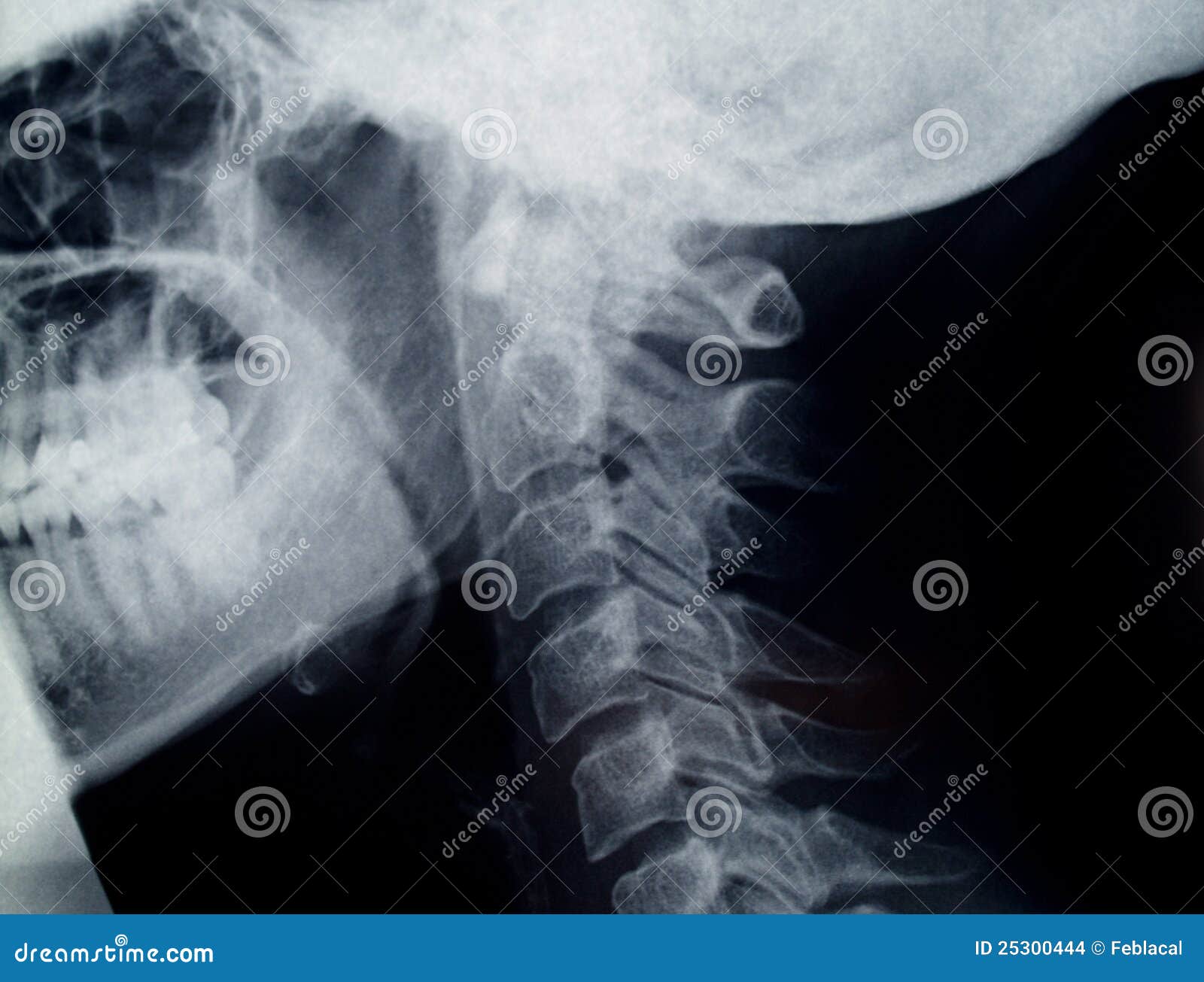 De radiografie van de hals stock foto. Image of diagnose - 25300444