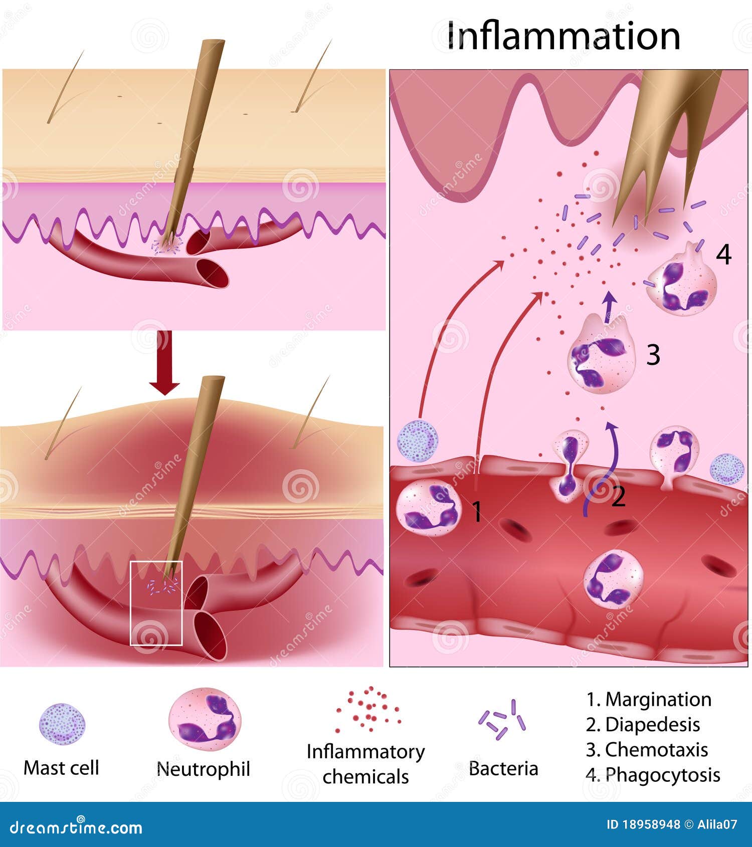 De Reactie Van De Ontsteking Vector Illustratie - Illustration of ...