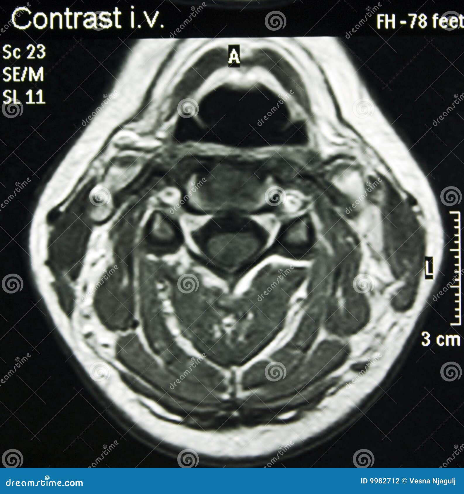 De Resonancia Magnética De Cuello Foto de archivo - Imagen de salud ...