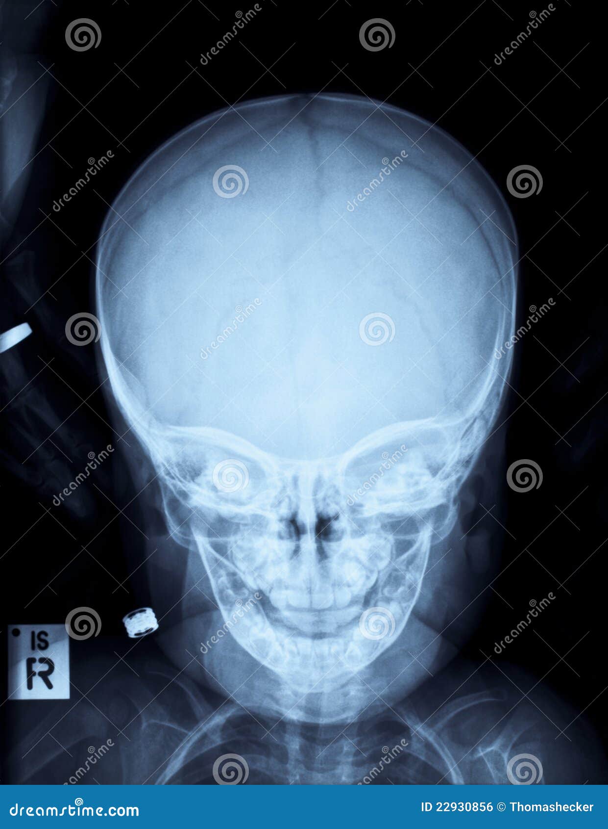 De Schedel X-ray Beeld Van Childs Stock Foto - Image of ongeval ...