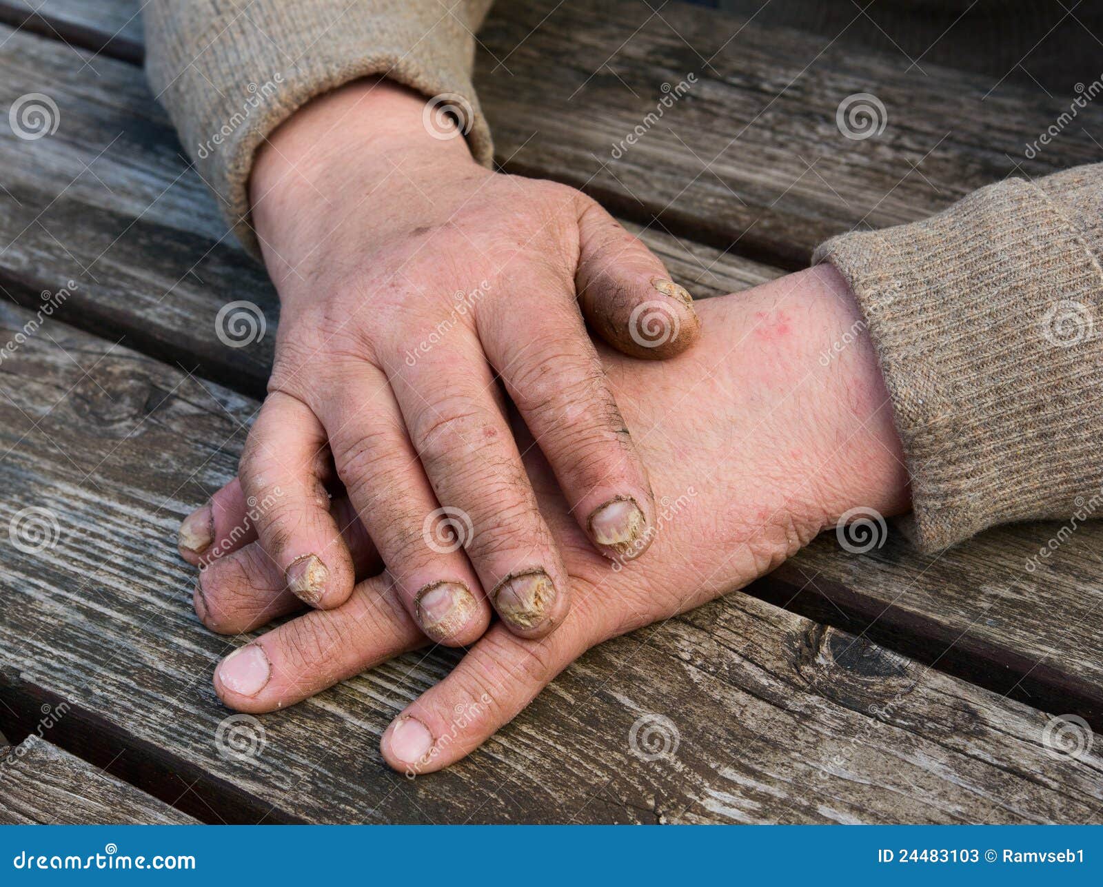 De Schimmel Besmetting Van De Spijker Stock Afbeelding - Image of ...