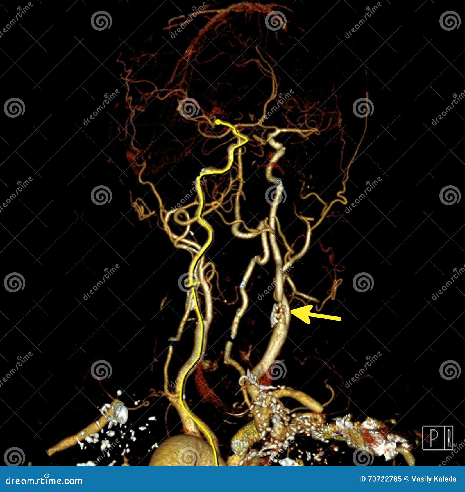 De Slagadervernauwing Van De Halsslagader Stock Afbeelding - Image of ...