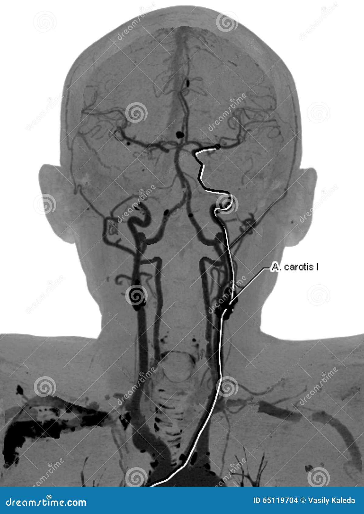 De Slagaderziekte Van De Halsslagader Stock Foto - Image of bloed ...