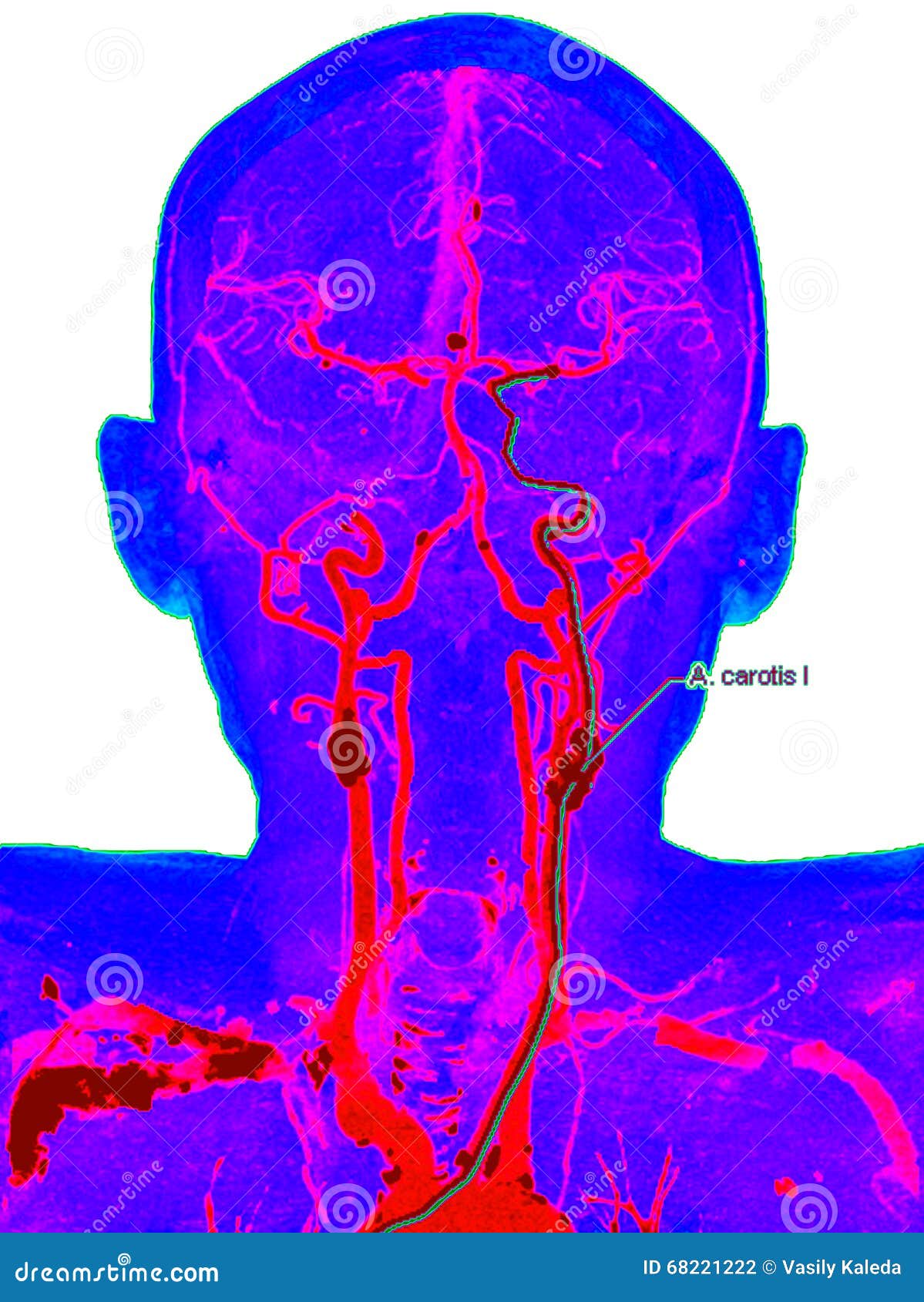 De Slagaderziekte Van De Halsslagader Stock Foto - Image of kenmerkend ...