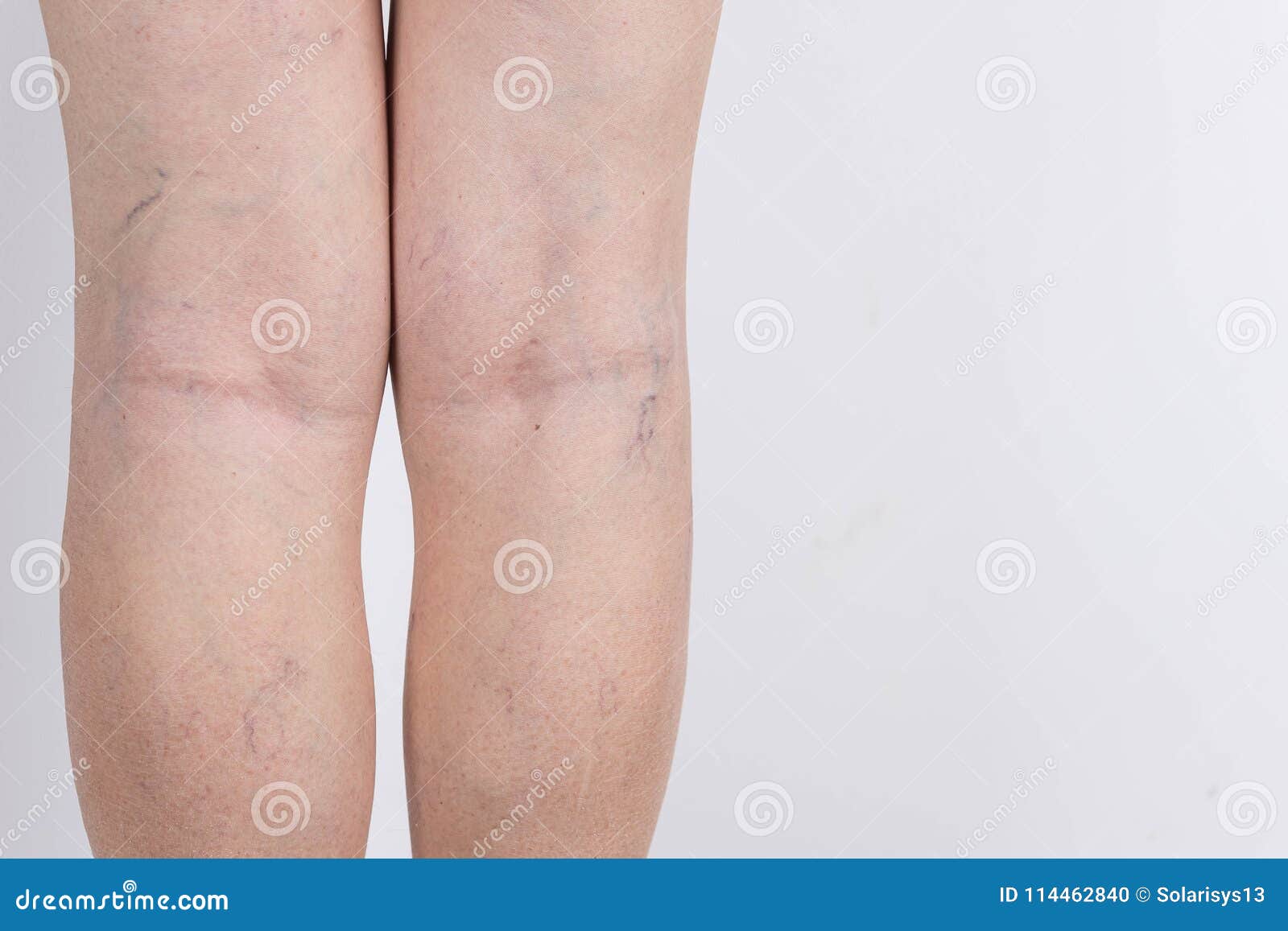 De Spataders Op Benen Van Vrouw Stock Foto - Image of voet, compressie ...