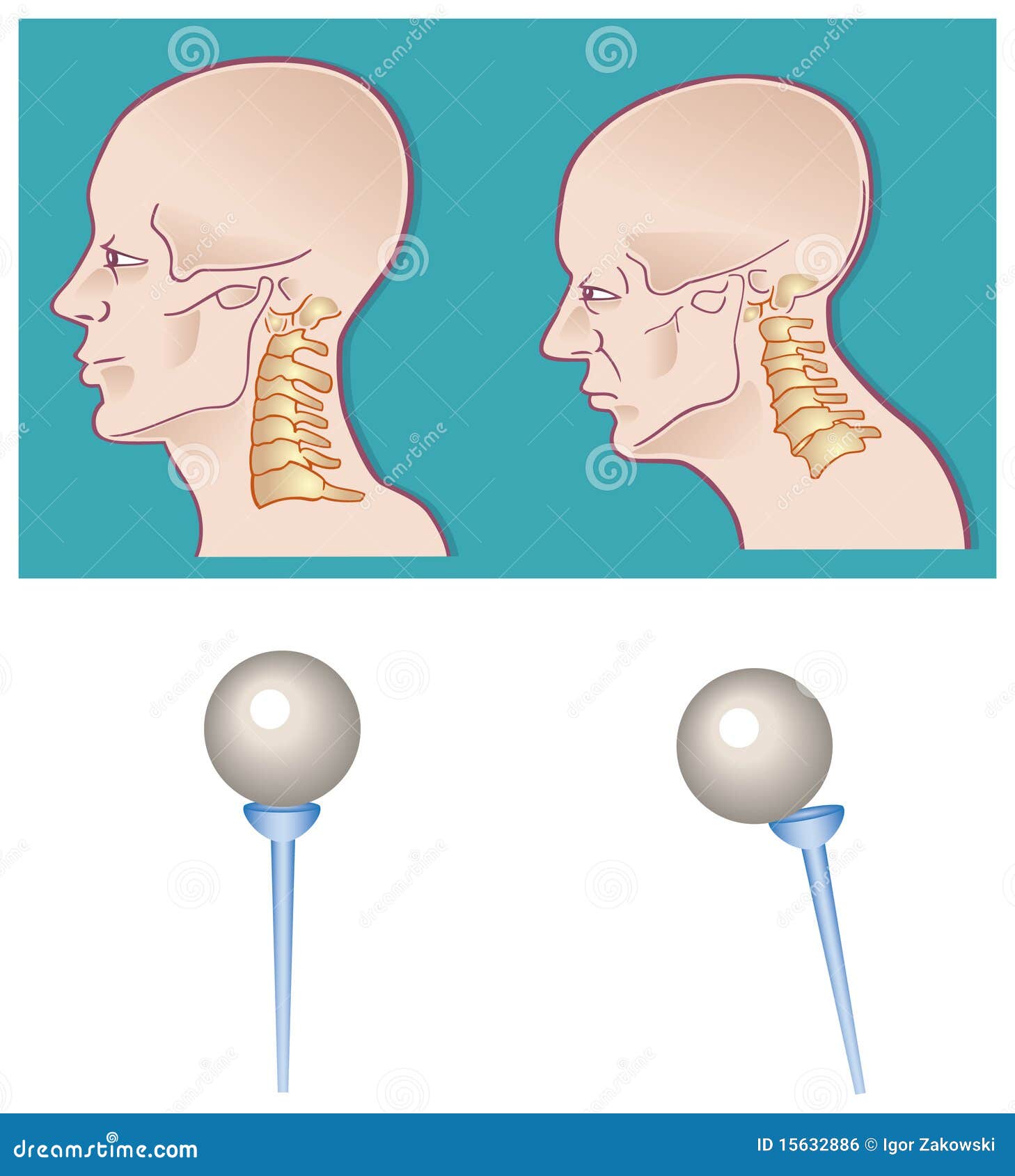 De stekel van de hals vector illustratie. Illustration of mens - 15632886