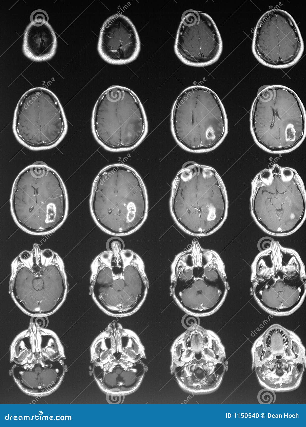 De Tumor Van Hersenen Op Mri Stock Foto - Image of magnetisch, contrast ...
