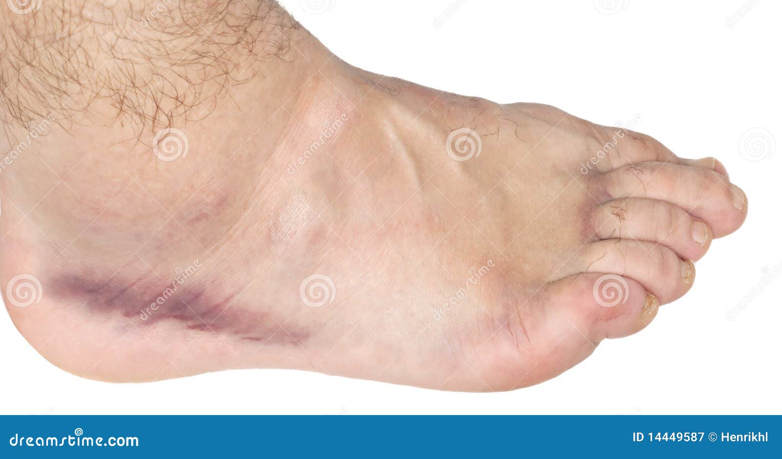 De Verstuiking Van De Enkel. Stock Afbeelding - Image of besproeid ...