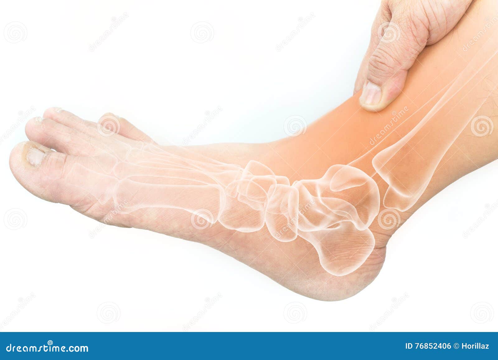 De Verwonding Van Voetbeenderen Stock Foto - Image of breuk ...