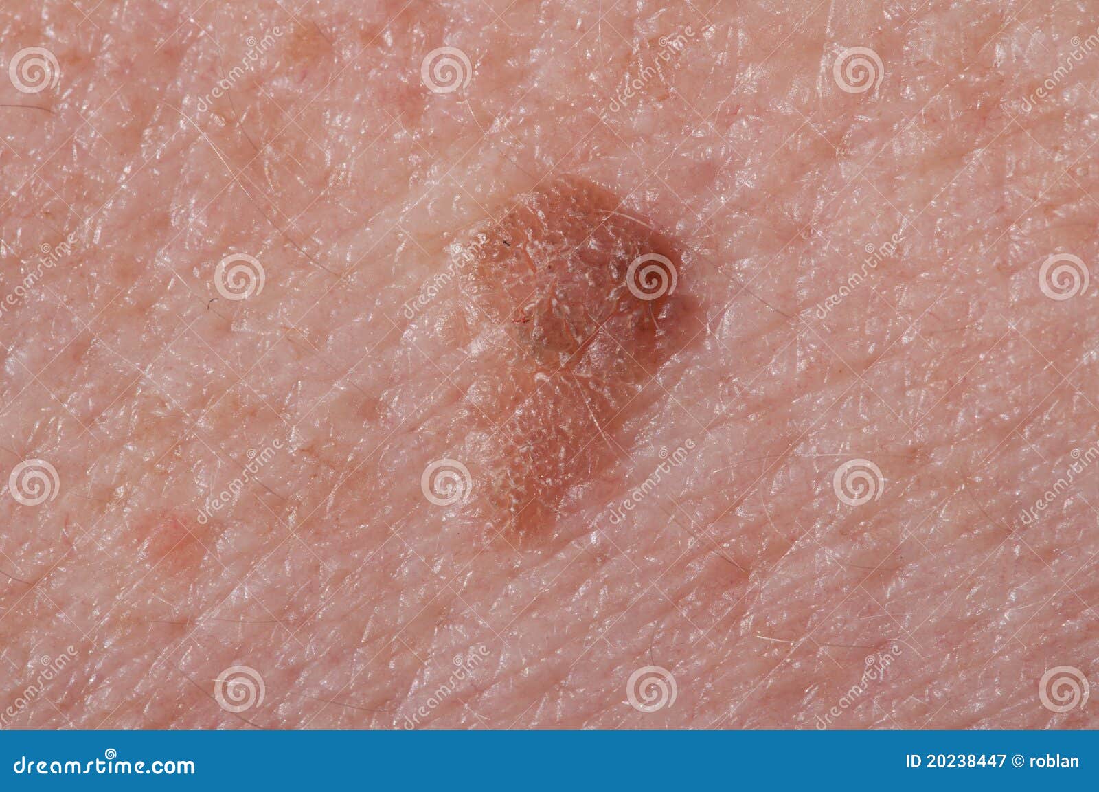 De vlekken van de lever stock afbeelding. Image of gezondheid - 20238447