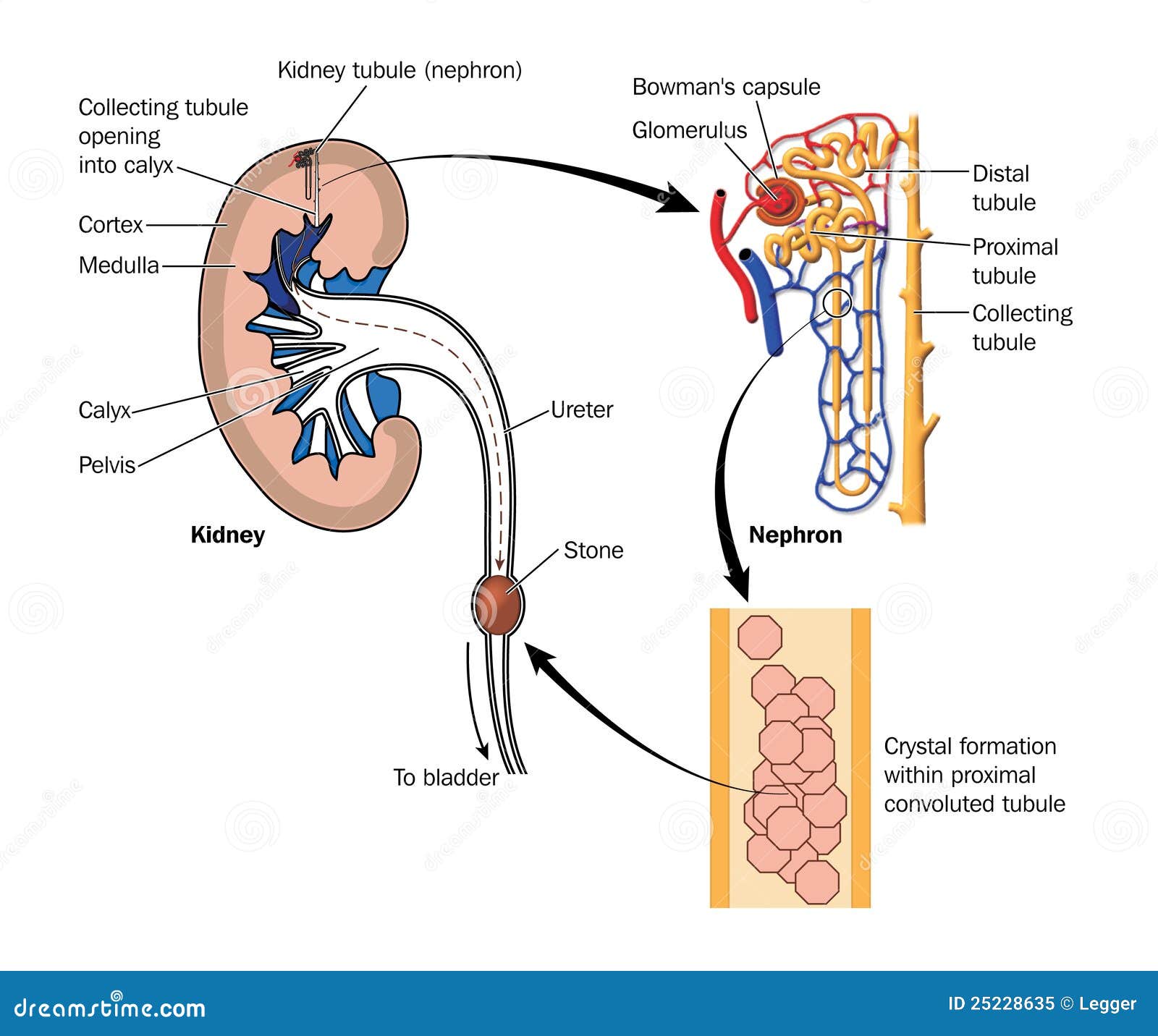 De Vorming Van De Niersteen Stock Illustratie - Illustration of medisch ...