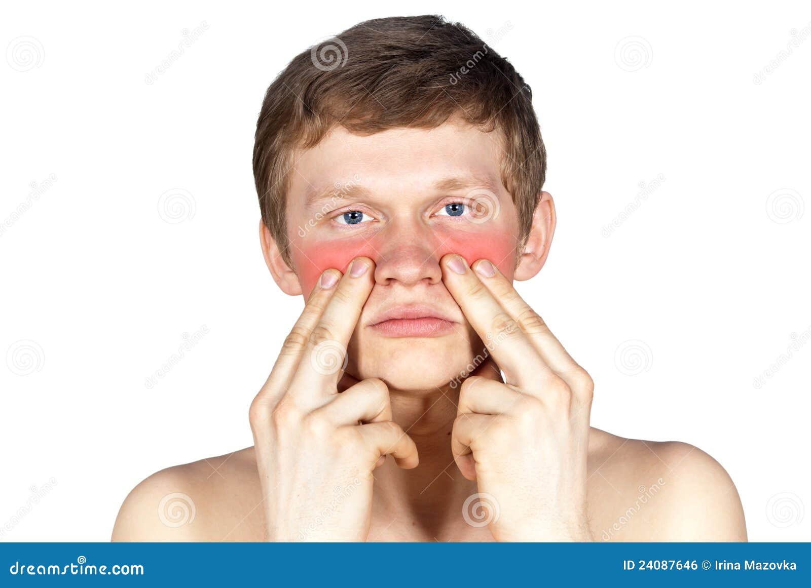 De Ziekte is Duidelijk Met Een Rode Neus Stock Foto - Image of mannetje ...