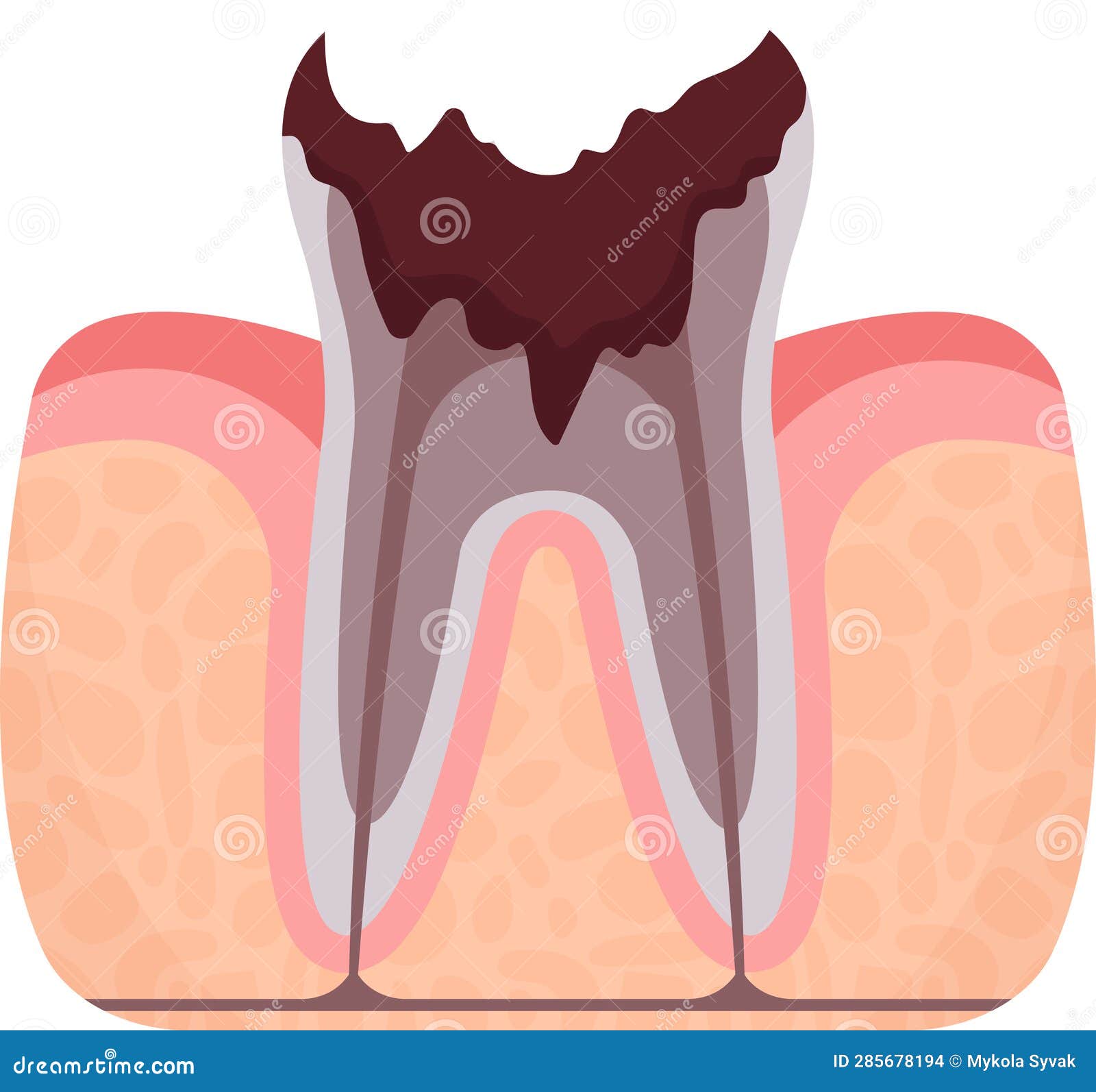 Dead Tooth Problem stock vector. Illustration of abscess - 285678194