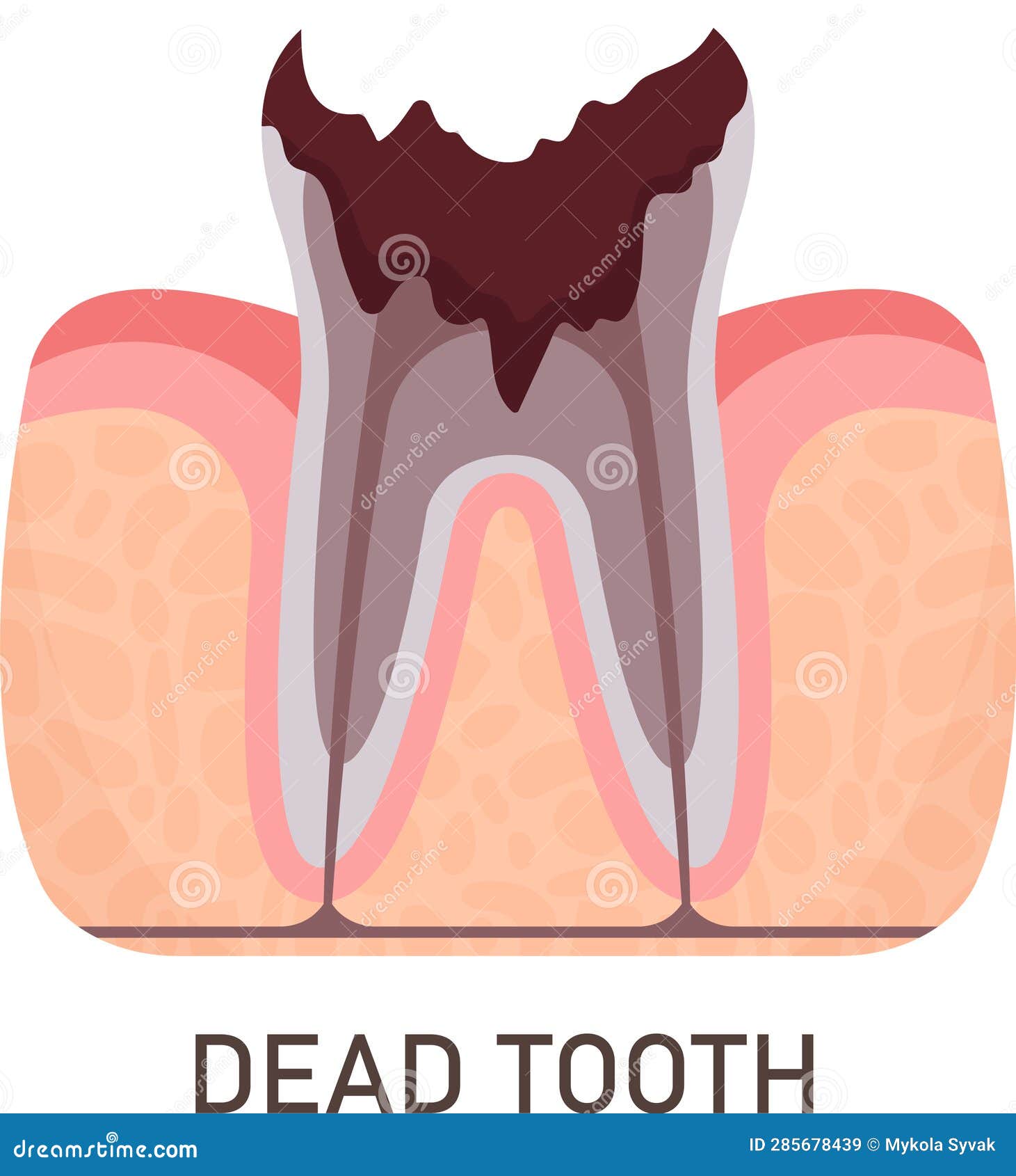 Dead Tooth Problem stock vector. Illustration of dentistry - 285678439