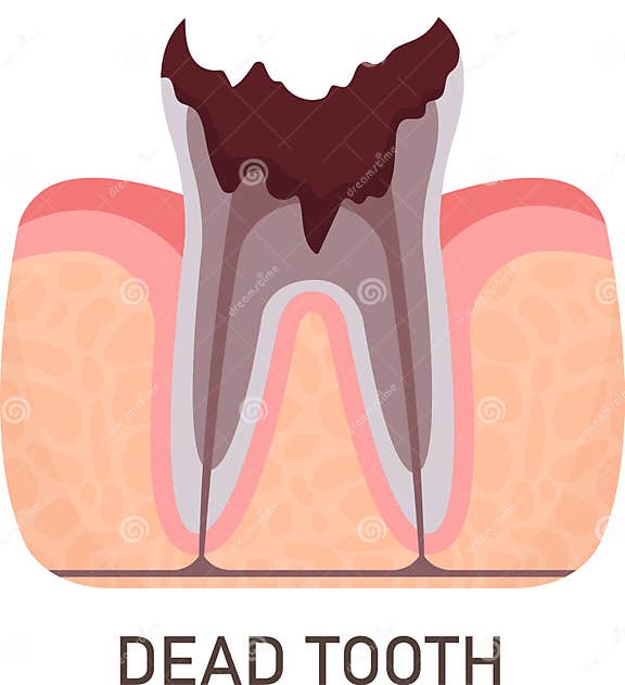 Dead Tooth Problem stock vector. Illustration of dentistry - 285678439