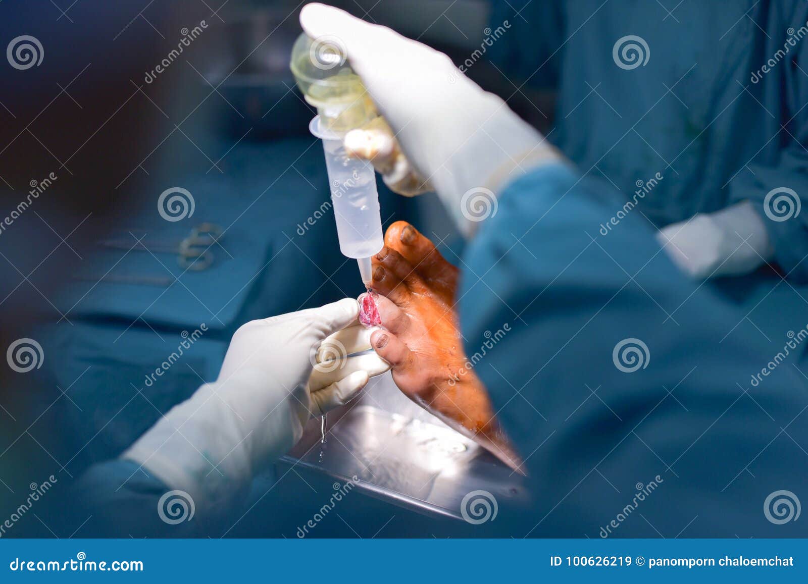 Operation stock image. Image of surgery, procedure, debridement - 100626219