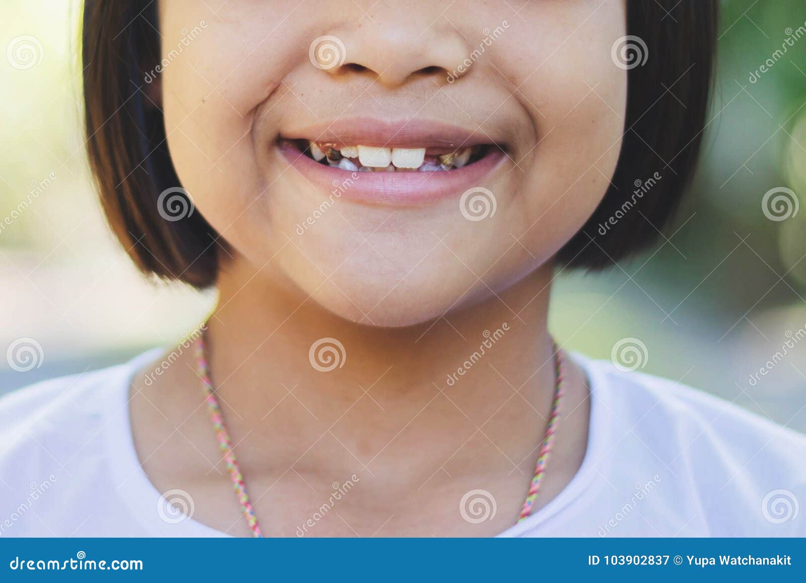 Asian kid`s decayed teeth stock image. Image of people - 103902837