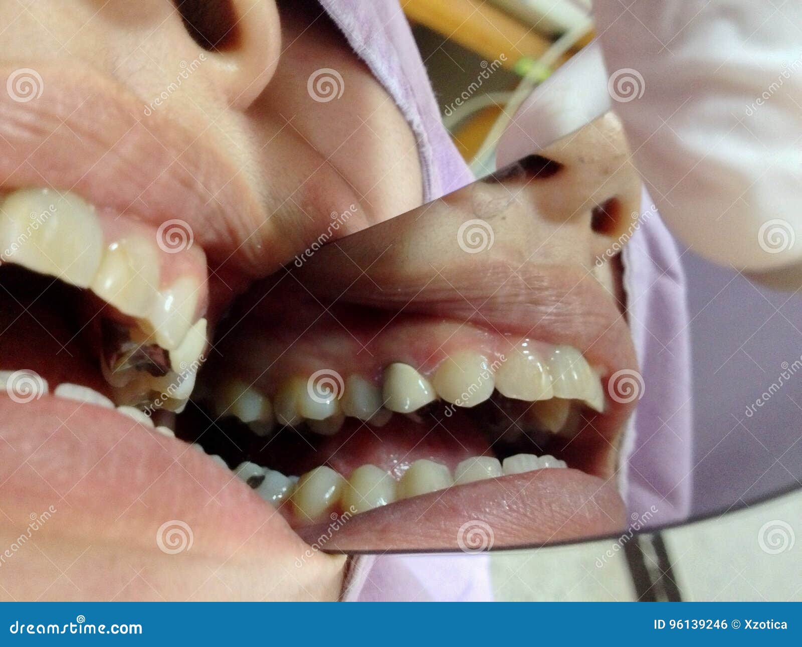 Decayed teeth check-up stock photo. Image of pathology - 96139246