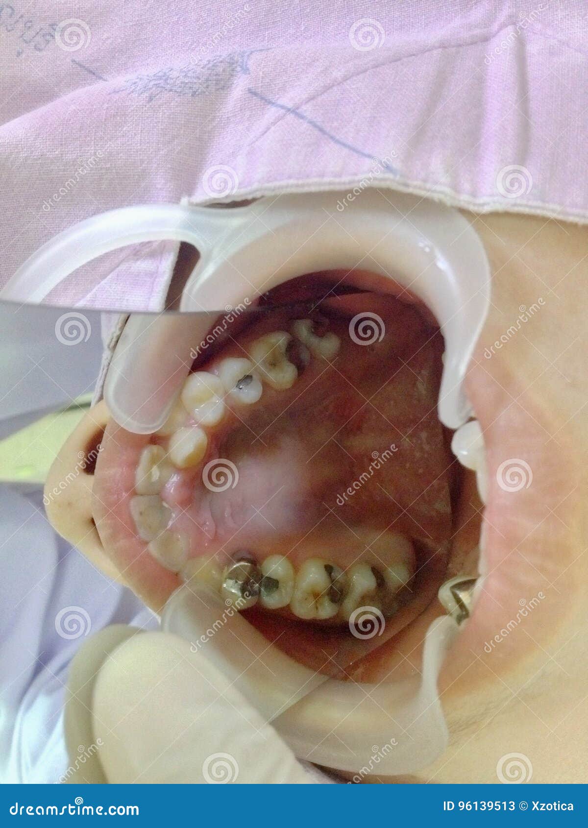 Decayed teeth check-up stock image. Image of disease - 96139513