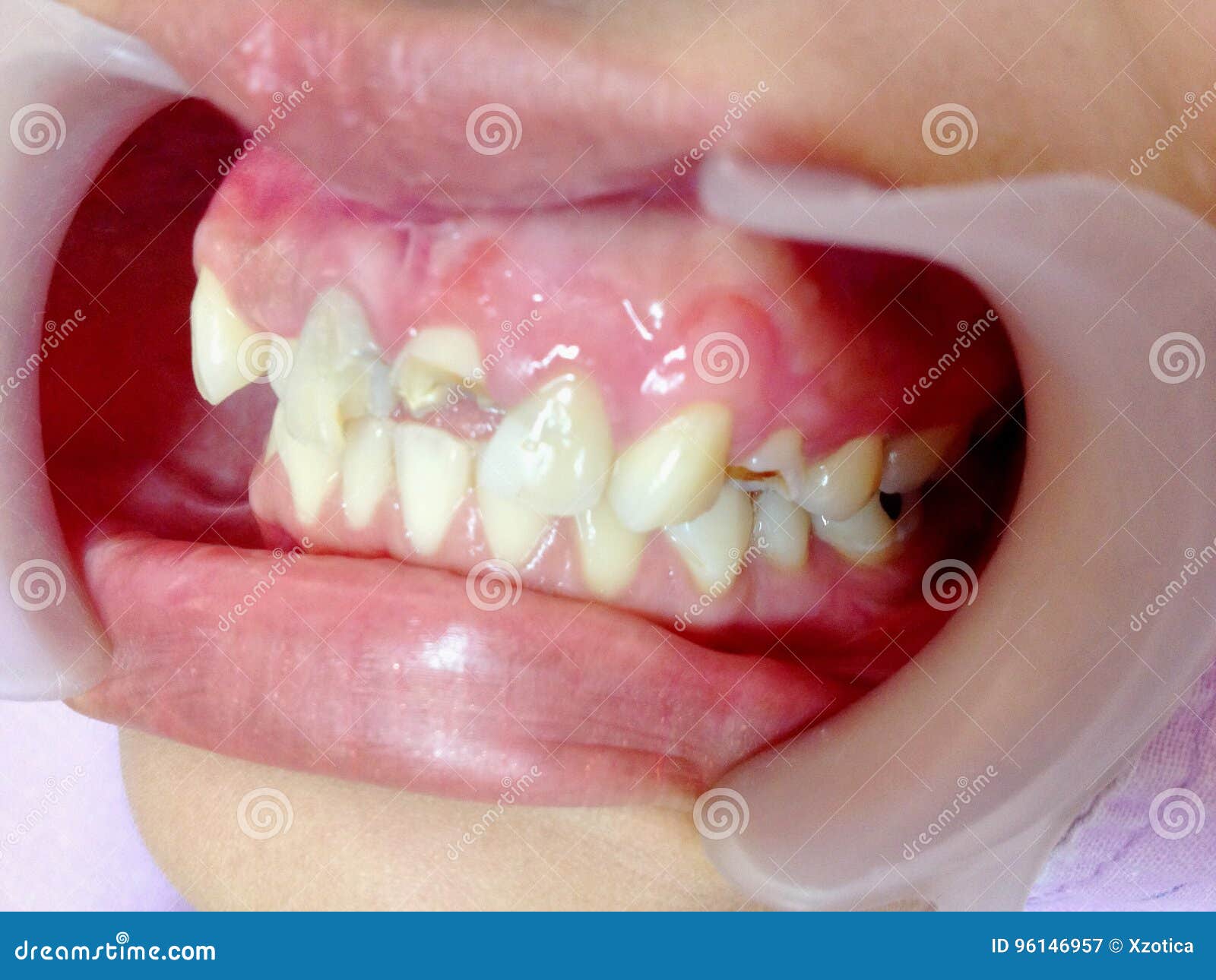 Decayed teeth check-up stock image. Image of hygiene - 96146957