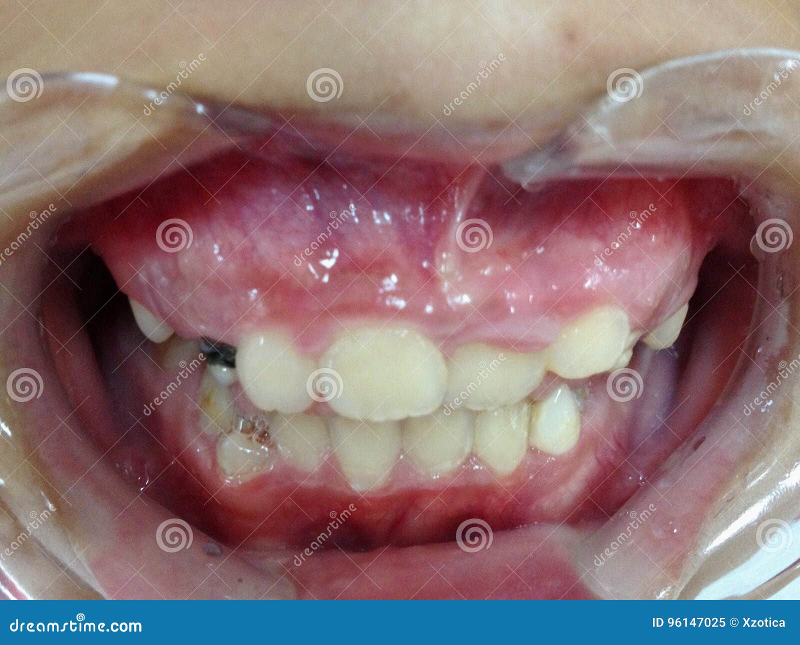 Decayed teeth check-up stock image. Image of patient - 96147025