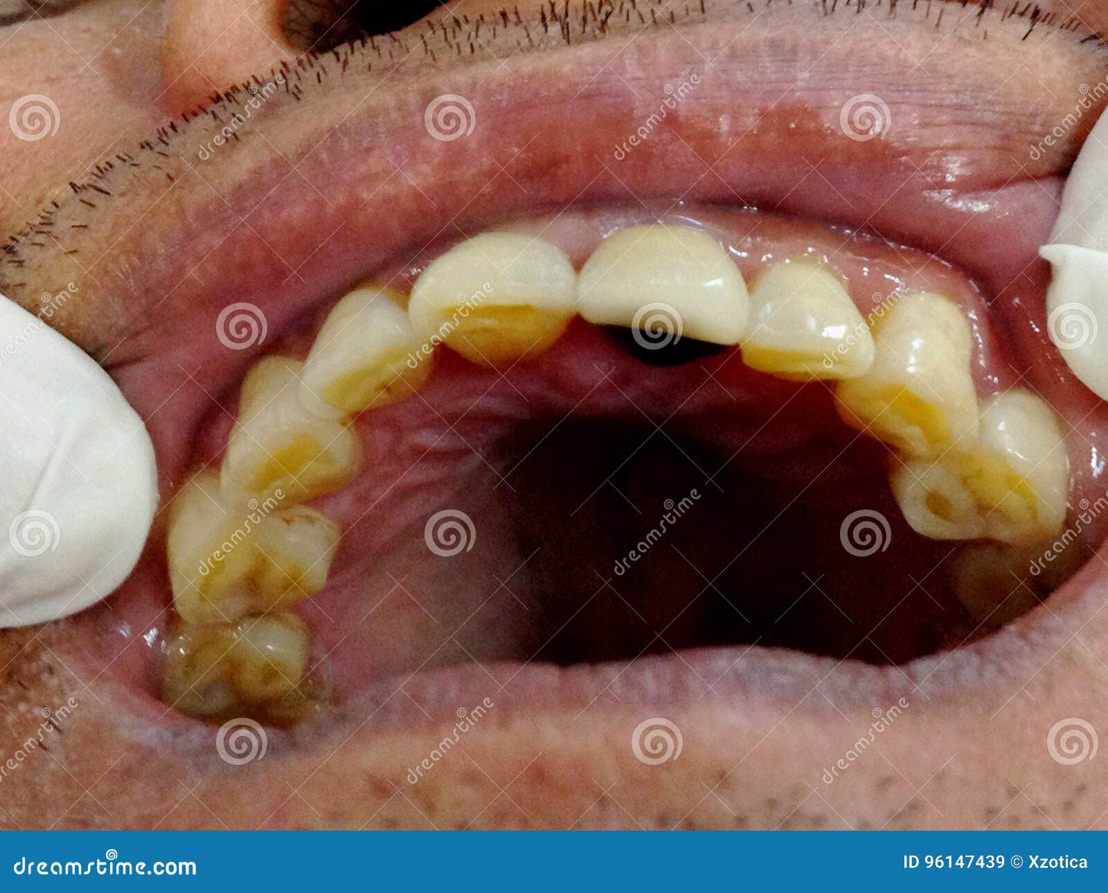 Decayed teeth check-up stock image. Image of health, clinical - 96147439