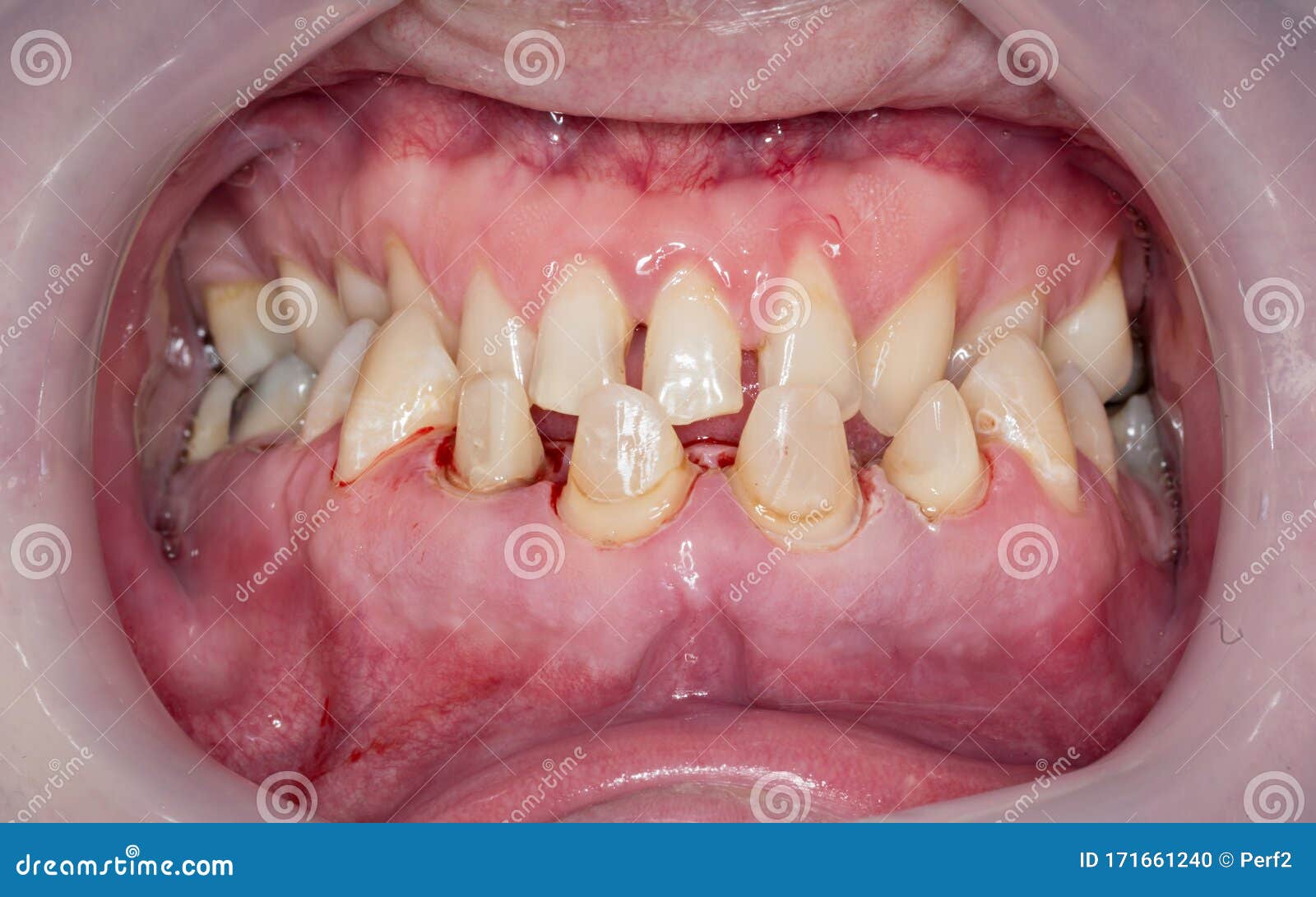 Decayed teeth stock photo. Image of broken, mouth, poor - 171661240