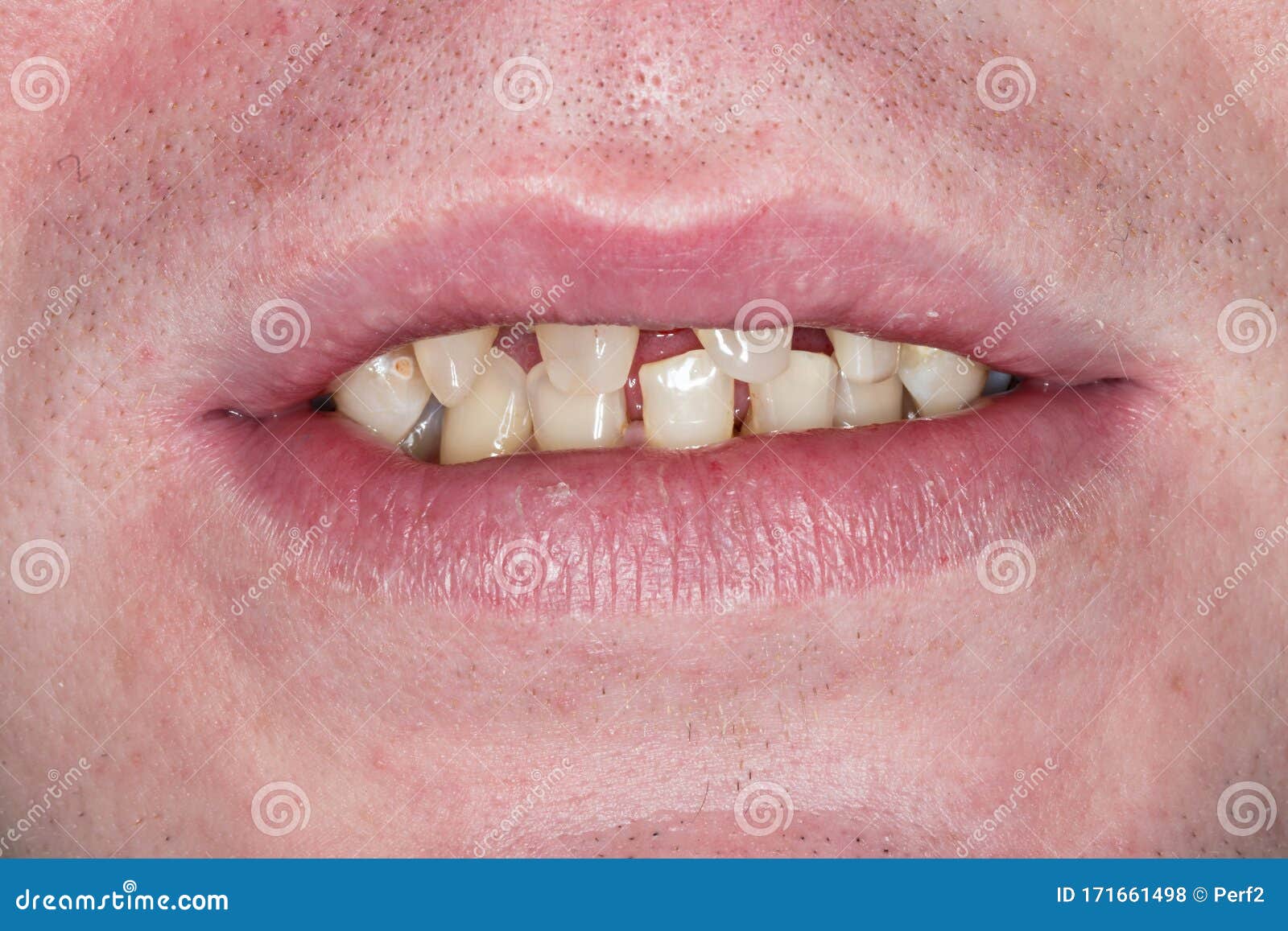 Decayed teeth stock photo. Image of poor, health, decayed - 171661498