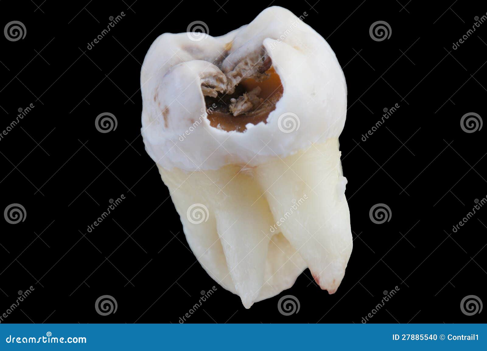 Decayed tooth stock photo. Image of tooth, decay, white - 27885540