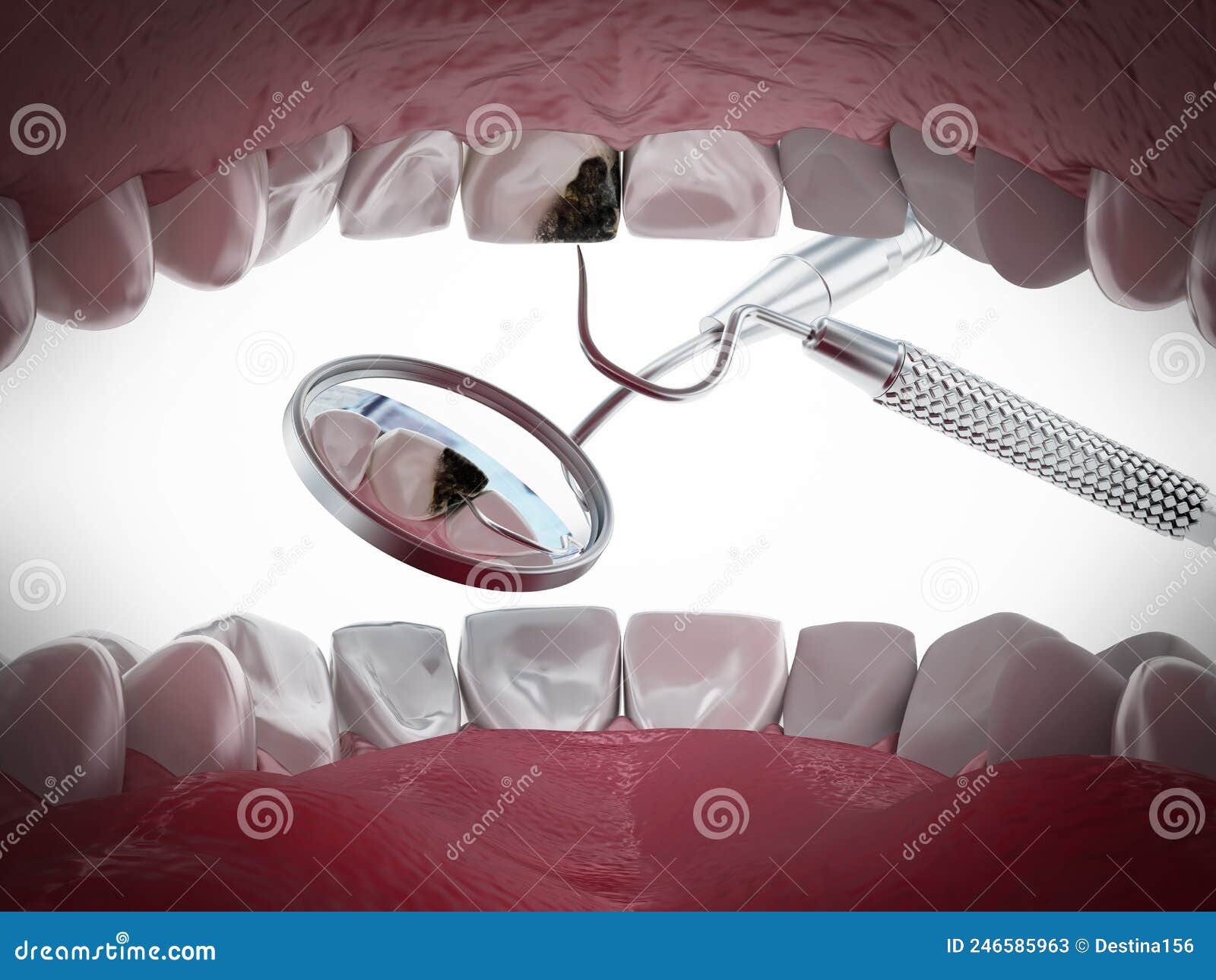 Decayed Tooth Diagnosis and Treatment. 3D Illustration Stock ...