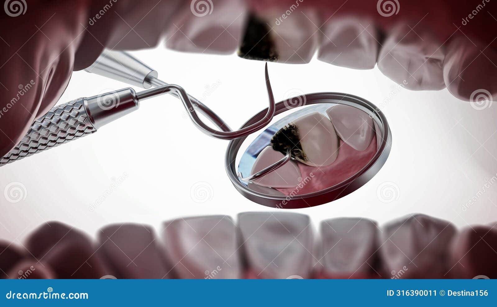 Decayed Tooth Diagnosis and Treatment. 3D Illustration Stock ...