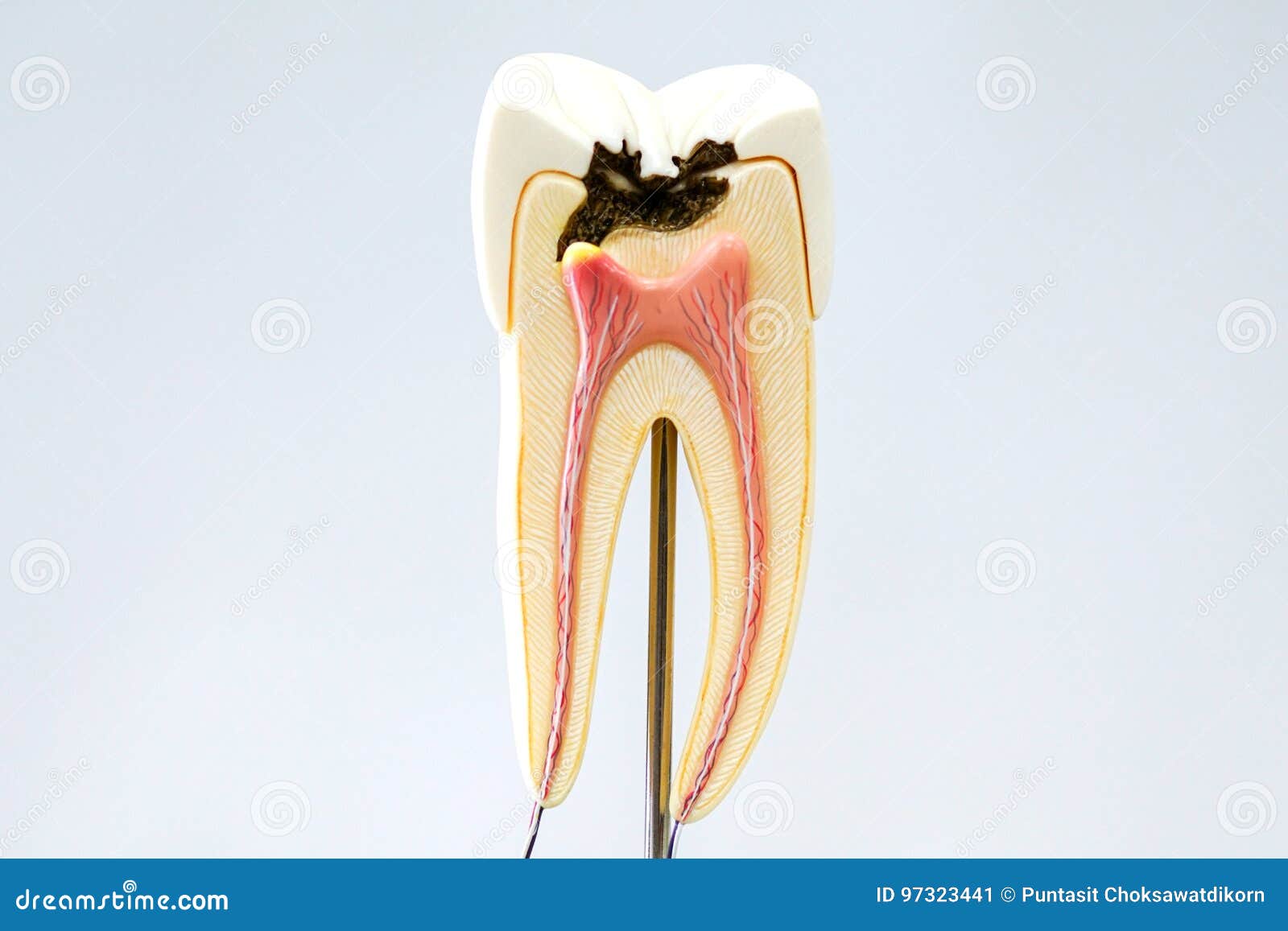 Decayed tooth model stock image. Image of medical, enamel - 97323441