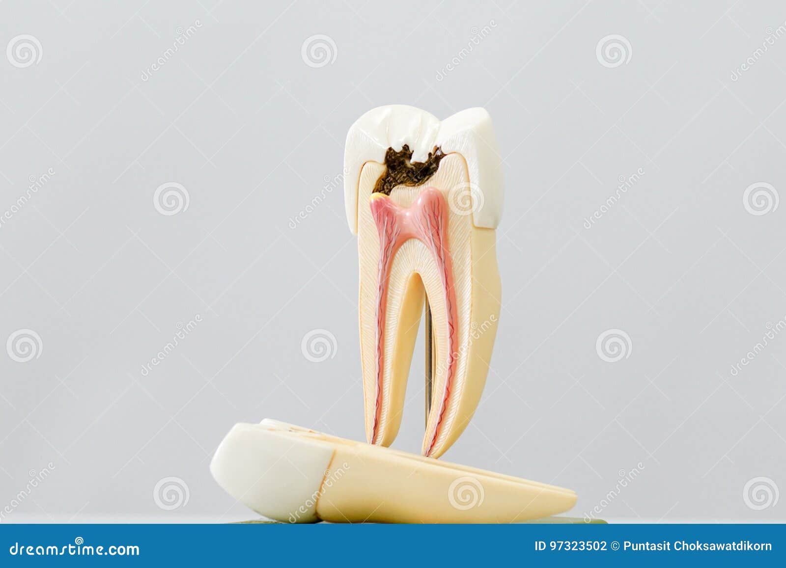 Decayed tooth model stock photo. Image of oral, enamel - 97323502