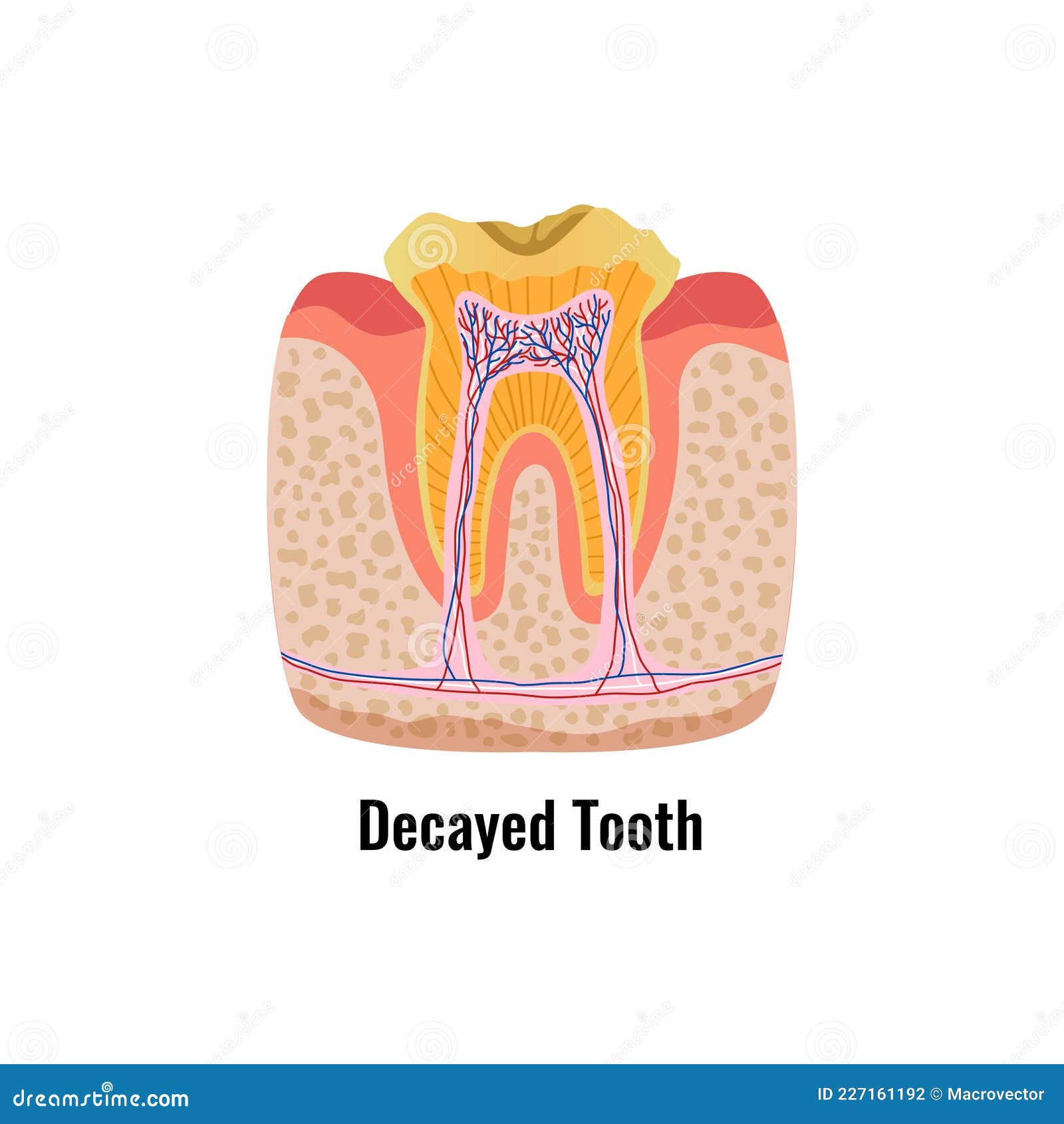 Decayed Tooth Poster Vector Illustration | CartoonDealer.com #227161192