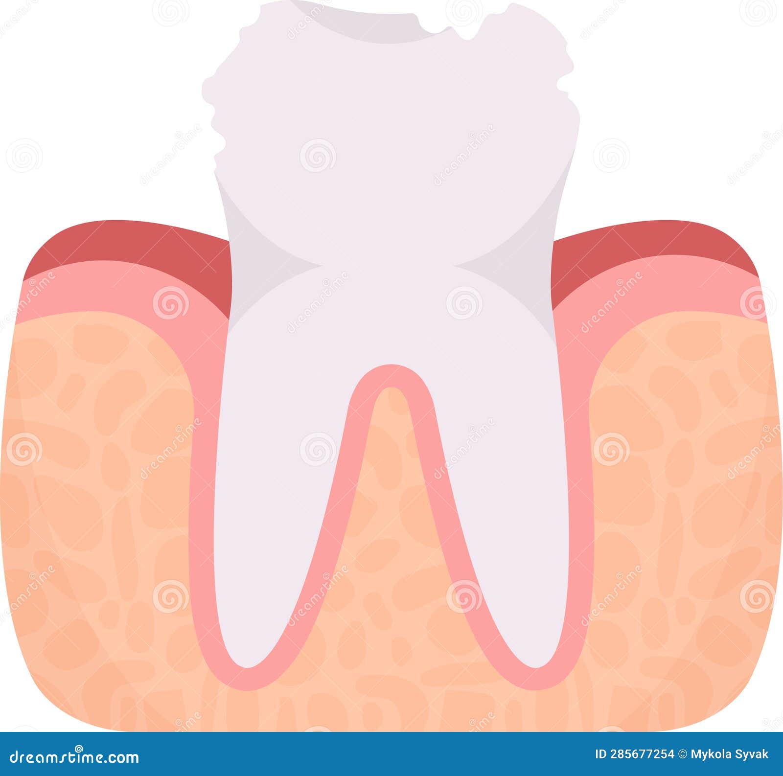 Decayed Tooth Problem stock vector. Illustration of dental - 285677254