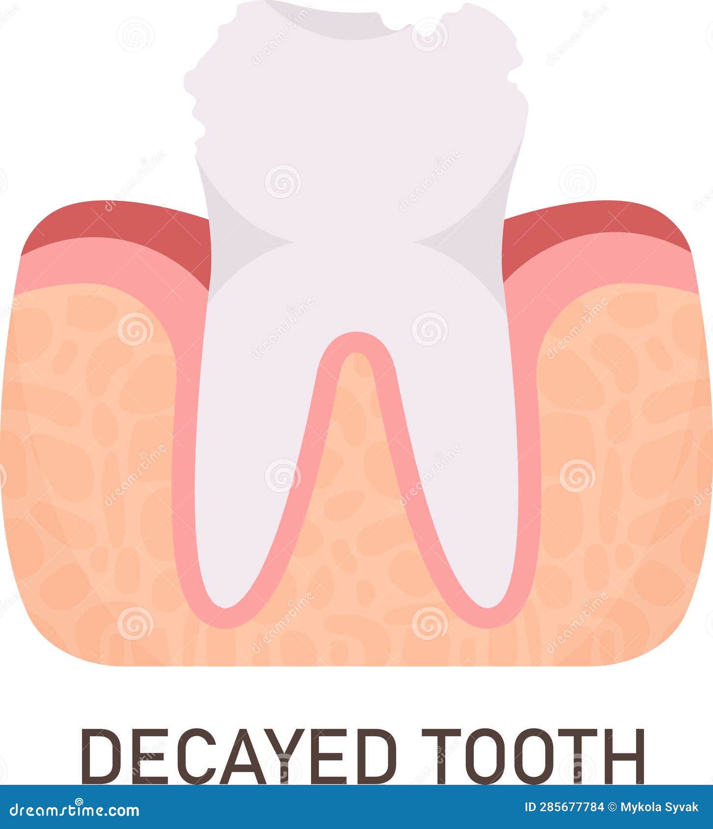 Decayed Tooth Problem stock vector. Illustration of toothache - 285677784