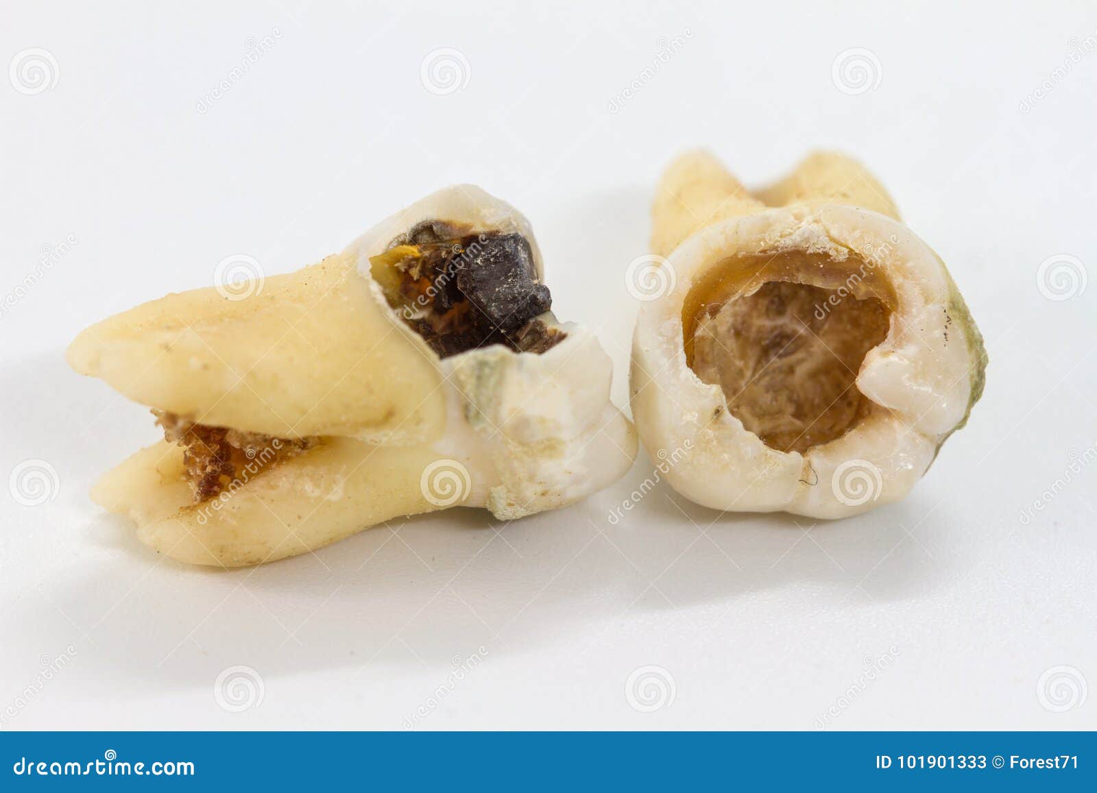 Extraction Of Decayed Tooth On White Background. Royalty-Free Stock ...
