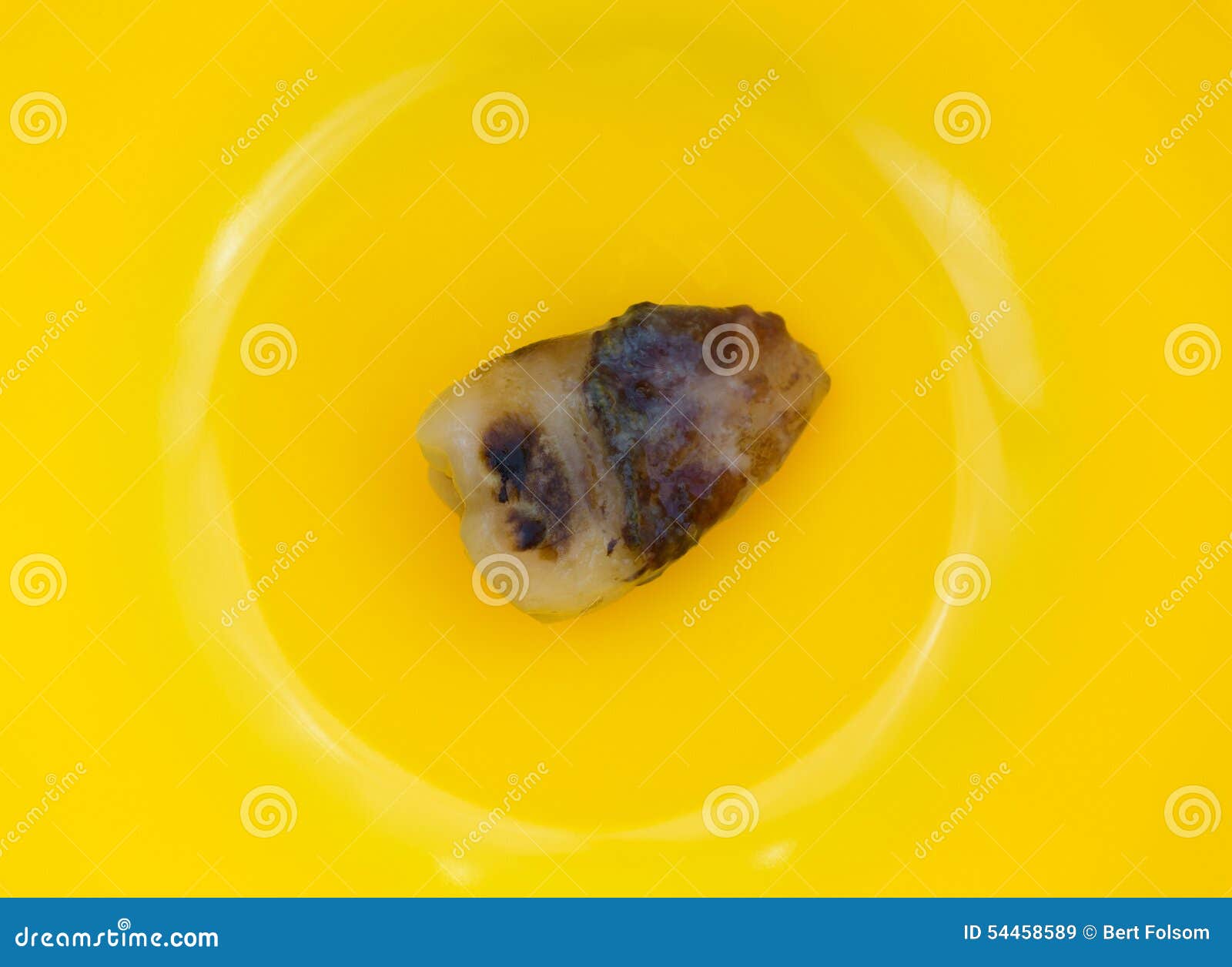Decayed Wisdom Tooth at the Bottom of a Bowl Stock Image - Image of ...