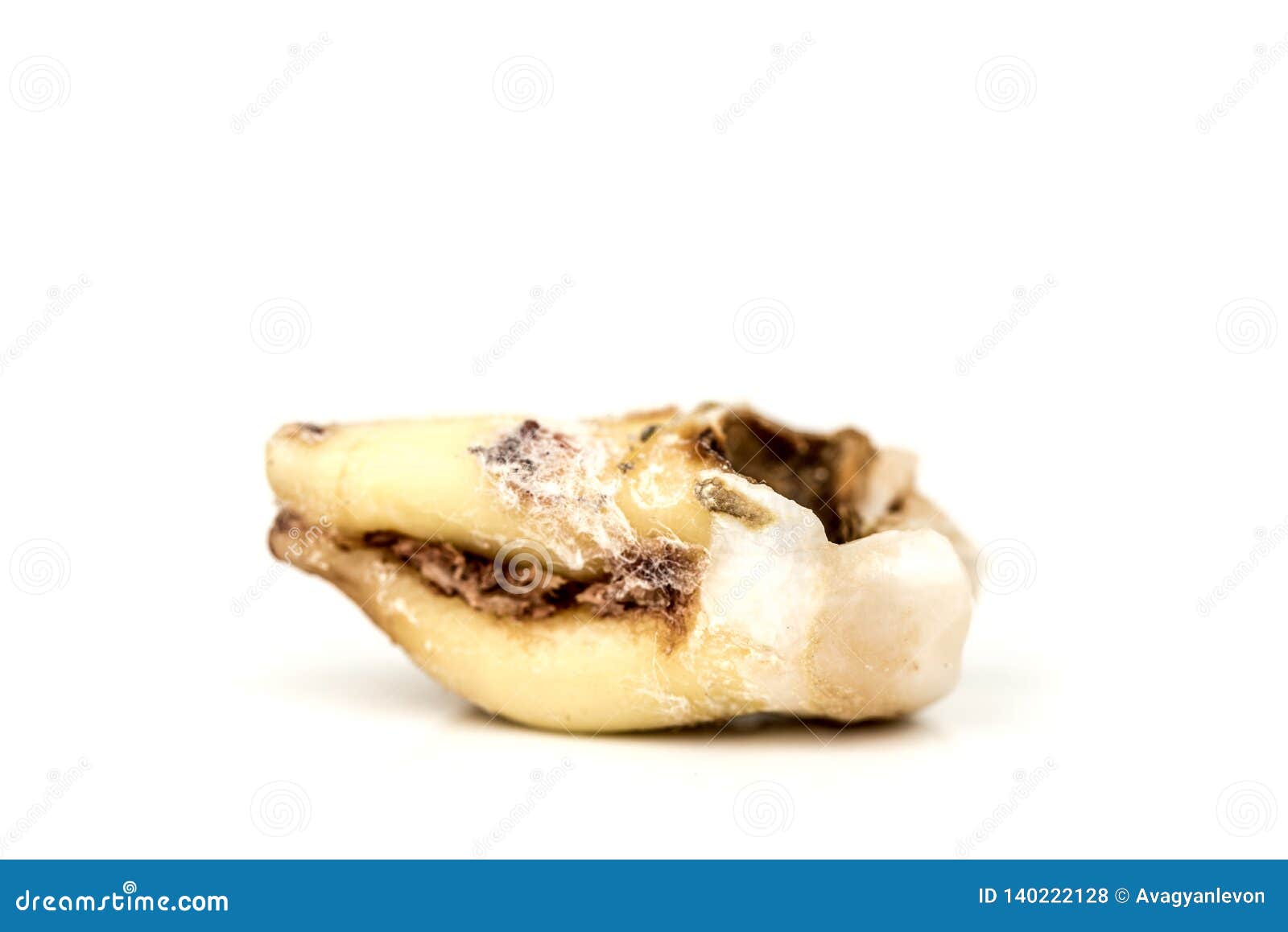 Decayed wisdom tooth stock photo. Image of teeth, background - 140222128