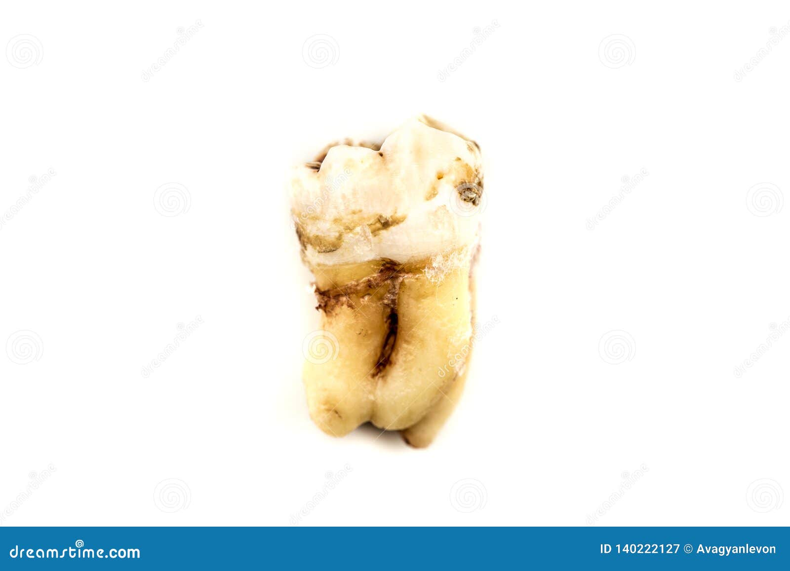 Decayed wisdom tooth stock image. Image of spoiled, stained - 140222127