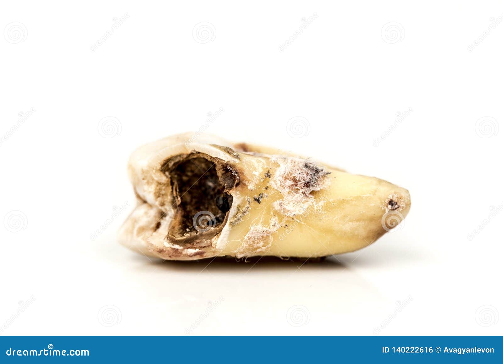 Decayed wisdom tooth stock photo. Image of human, decay - 140222616