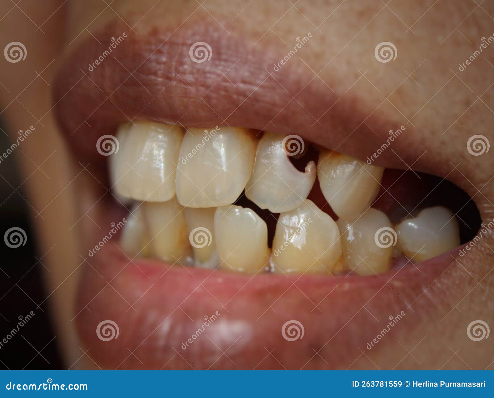 Decaying maxillary teeth stock image. Image of perforated - 263781559