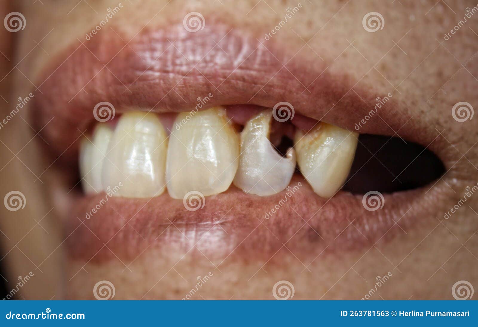 Decaying maxillary teeth stock image. Image of care - 263781563