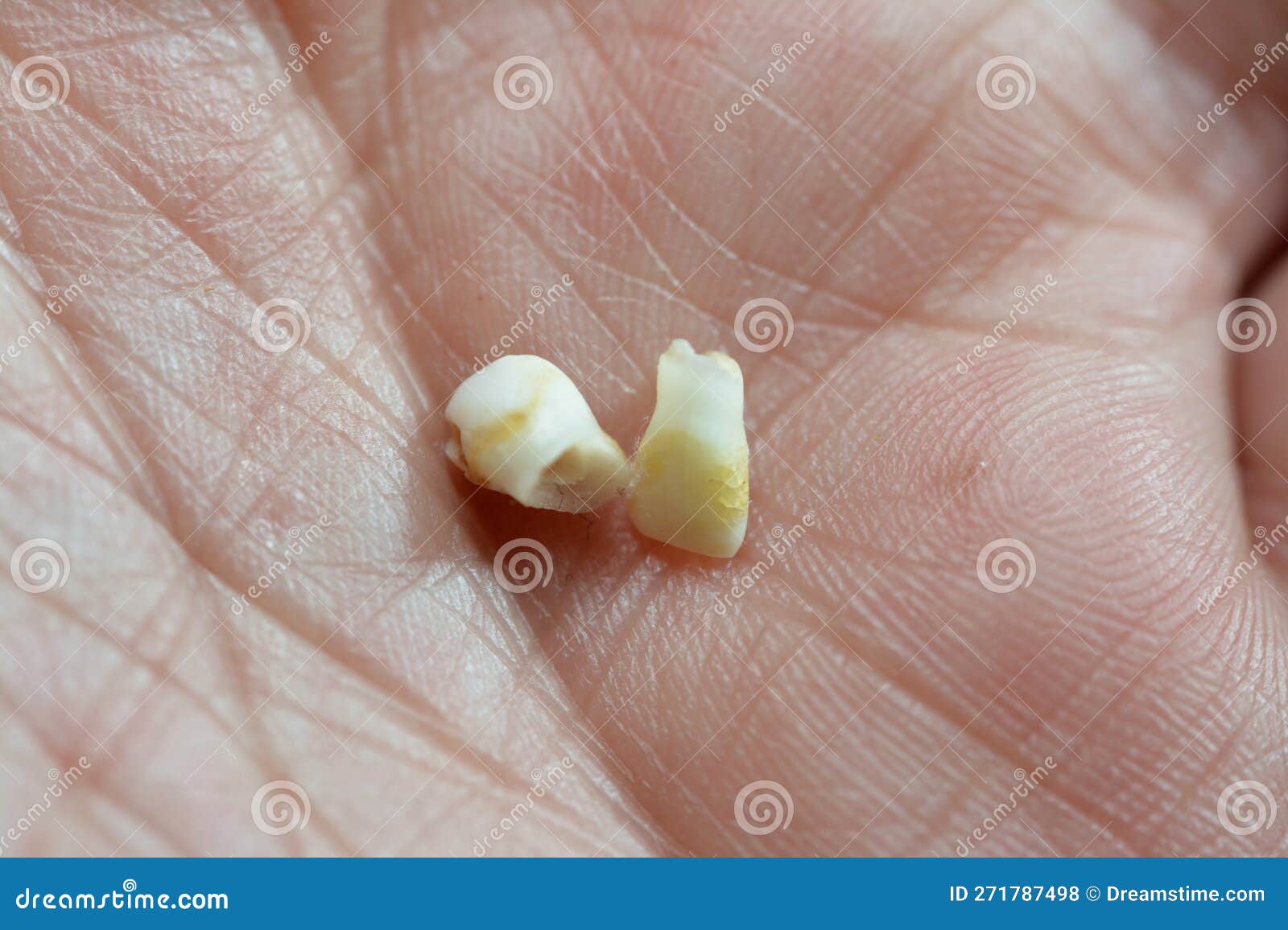 Deciduous Primary Baby Temporary Teeth, the First Set of Teeth in the ...
